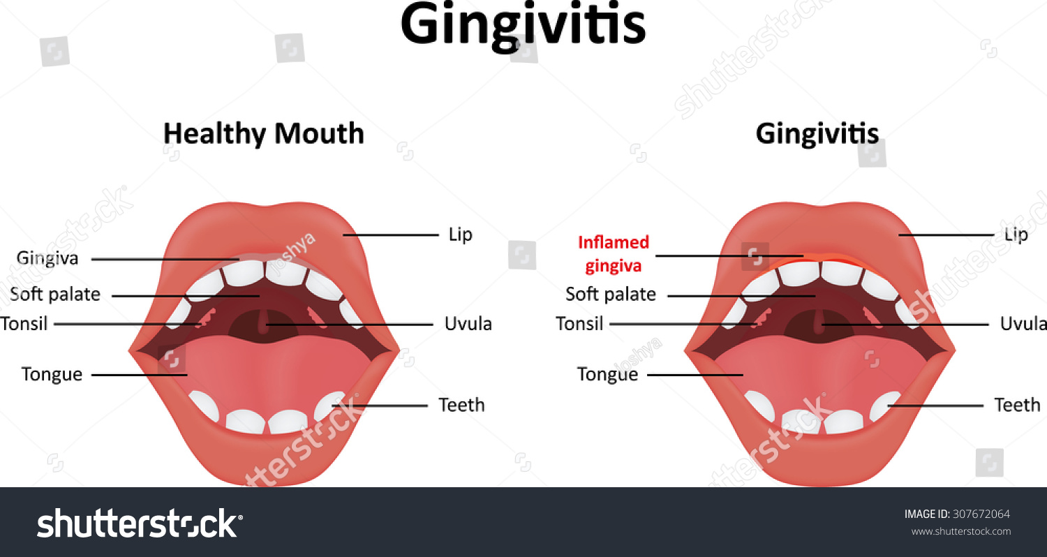 Gingivitis Stock Vector (Royalty Free) 307672064