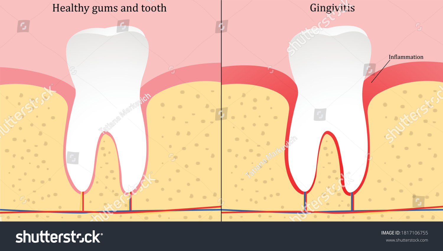 Gingivitis Gum Disease Vector Illustration Stock Vector (Royalty Free ...