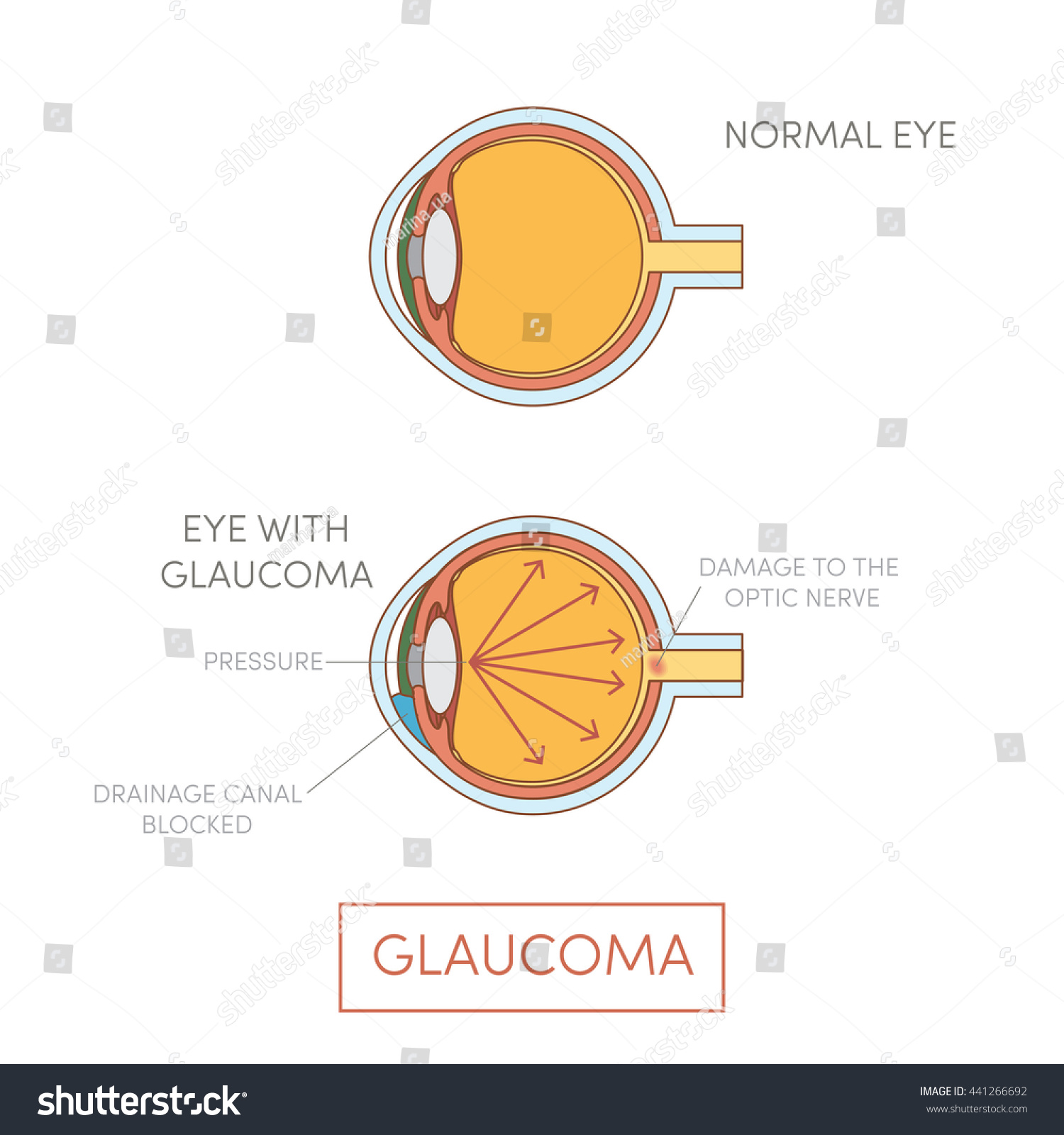 Glaucoma Eye Vector Human Eye Disorder Stock Vector (Royalty Free ...