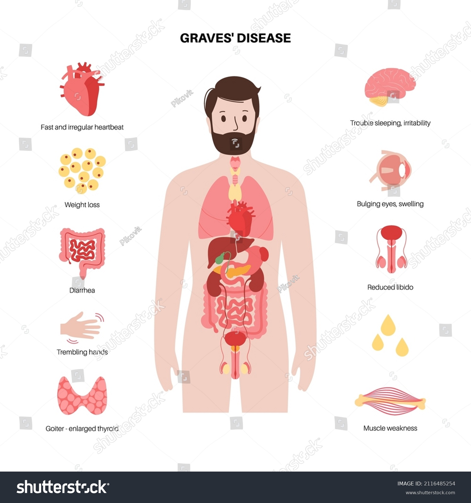 Graves Disease Medical Poster Hyperthyroidism Immune Stock Vector