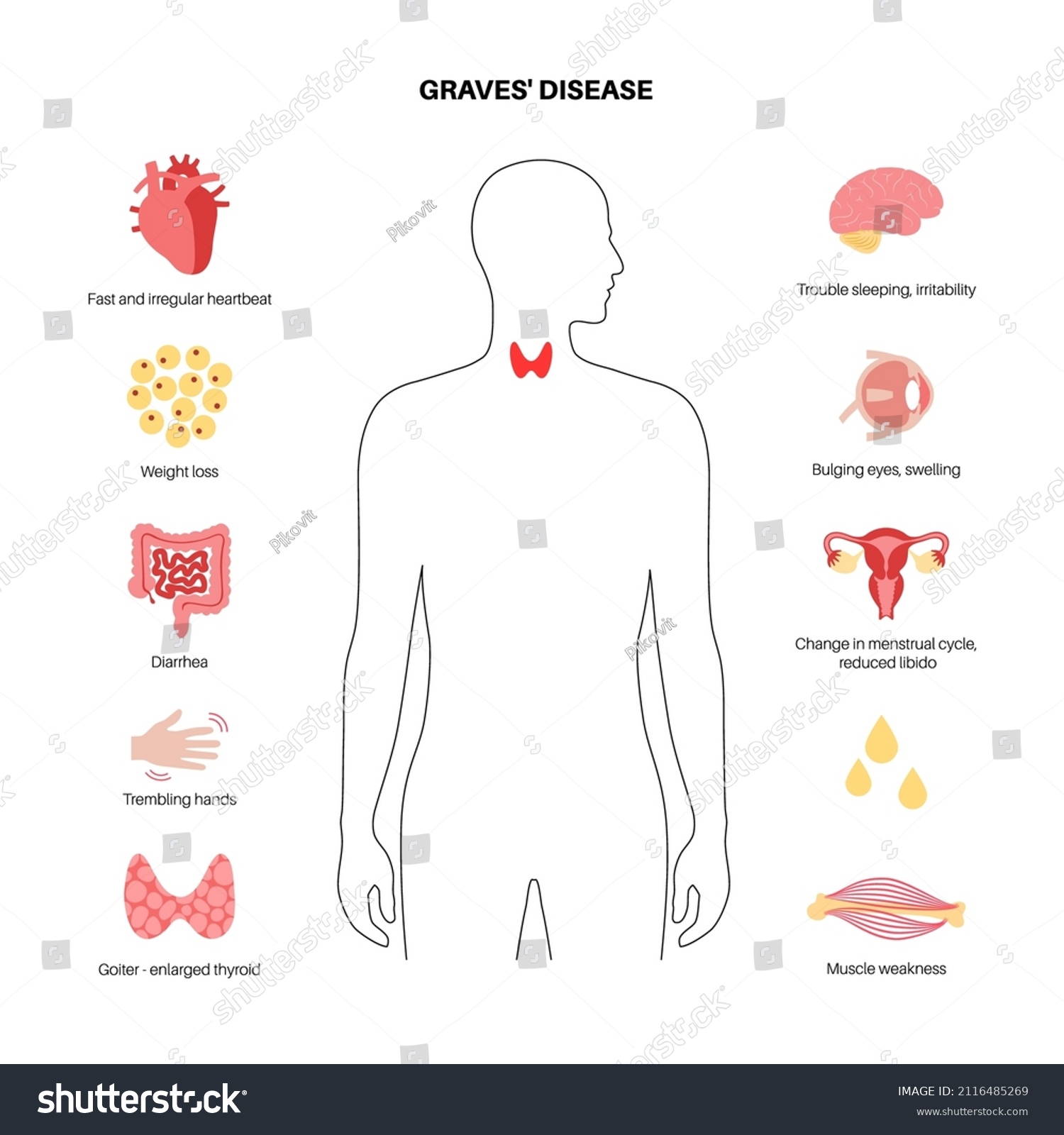 Graves Disease Medical Poster Hyperthyroidism Immune Stock Vector