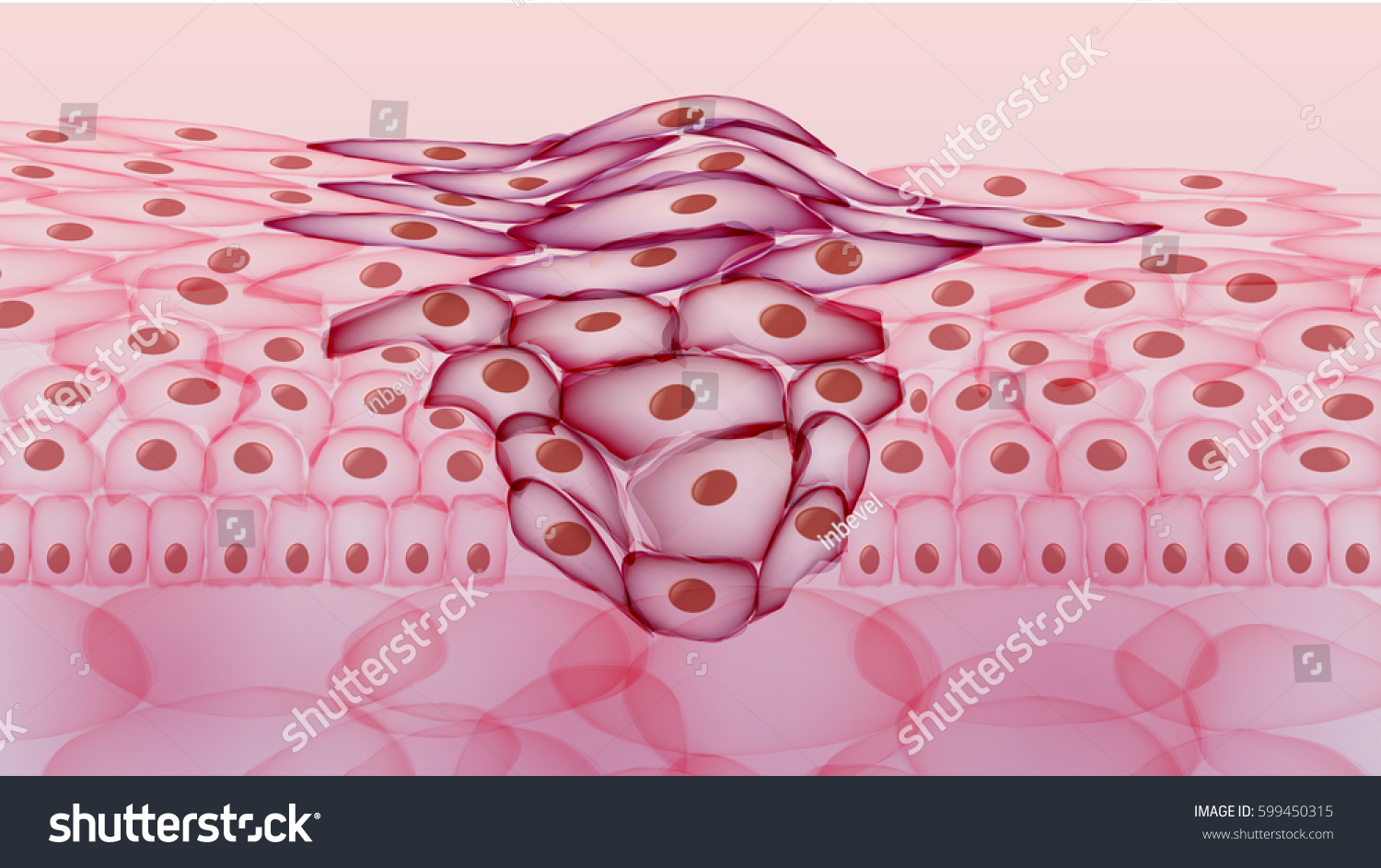 Growing Tumor Tissue Section Vector Illustration Stock Vector 599450315 ...