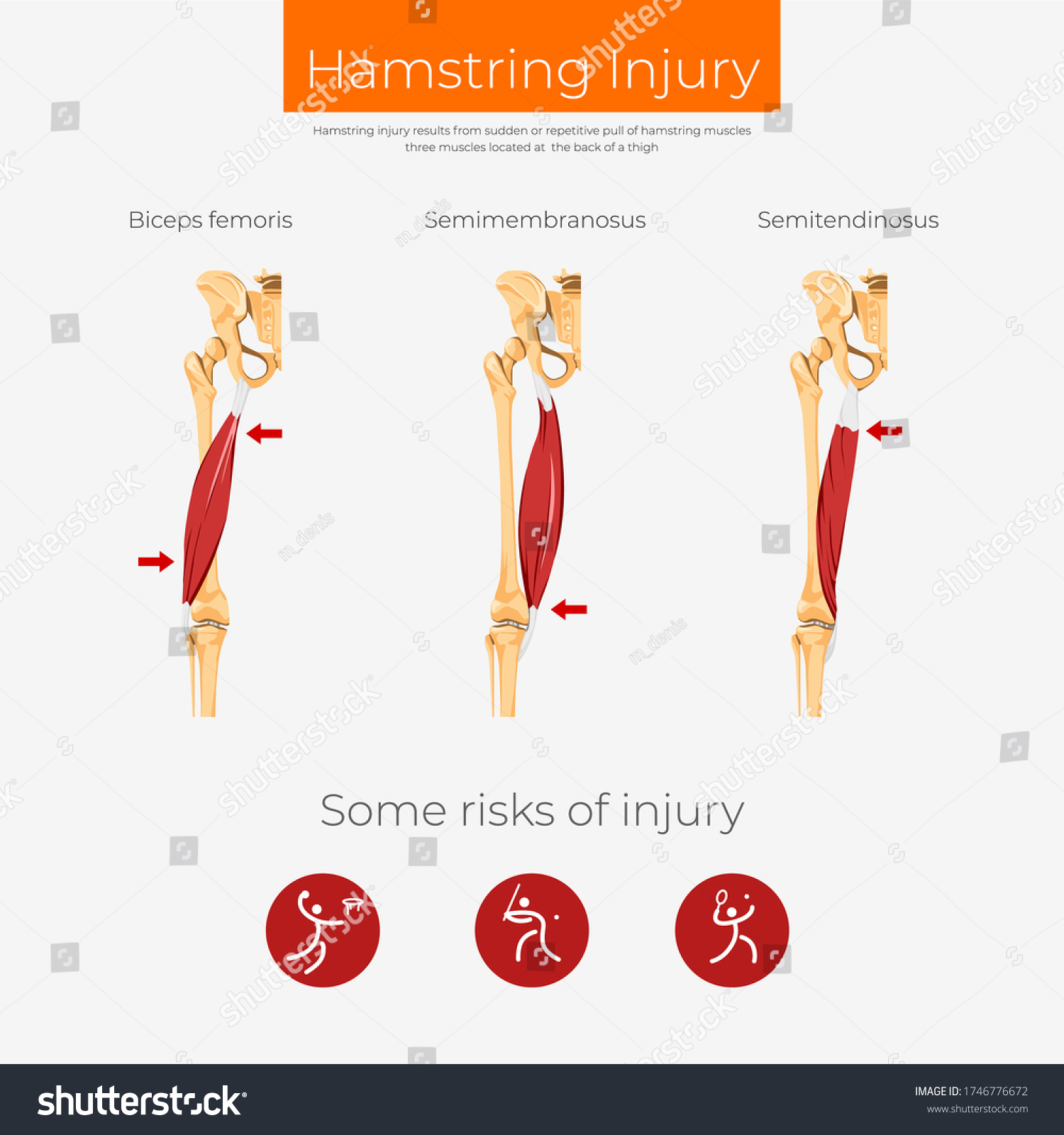Hamstring Injury Anatomy Scheme Poster: Vector có sẵn (miễn phí bản ...