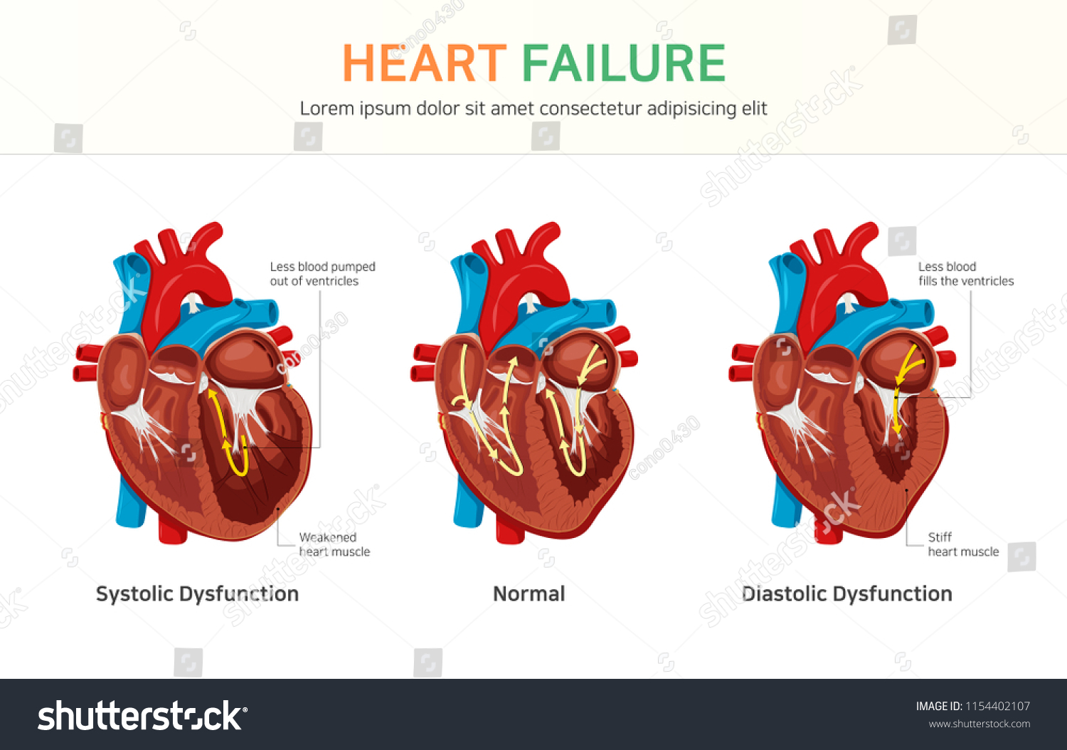3,952 Heart failure Stock Vectors, Images & Vector Art | Shutterstock