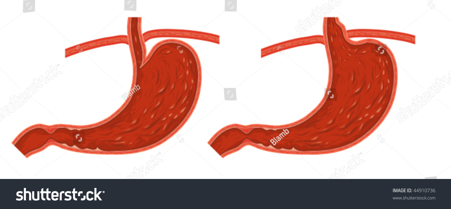 Hiatus Hernia Stock Vector (Royalty Free) 44910736