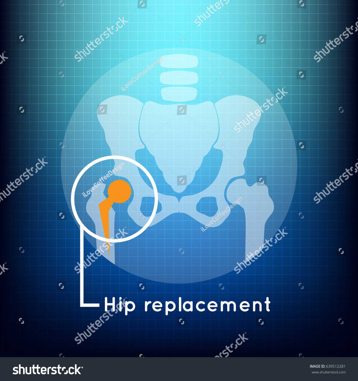 Hip Replacement Logo Vector Icon Design Stock Vector (Royalty Free ...
