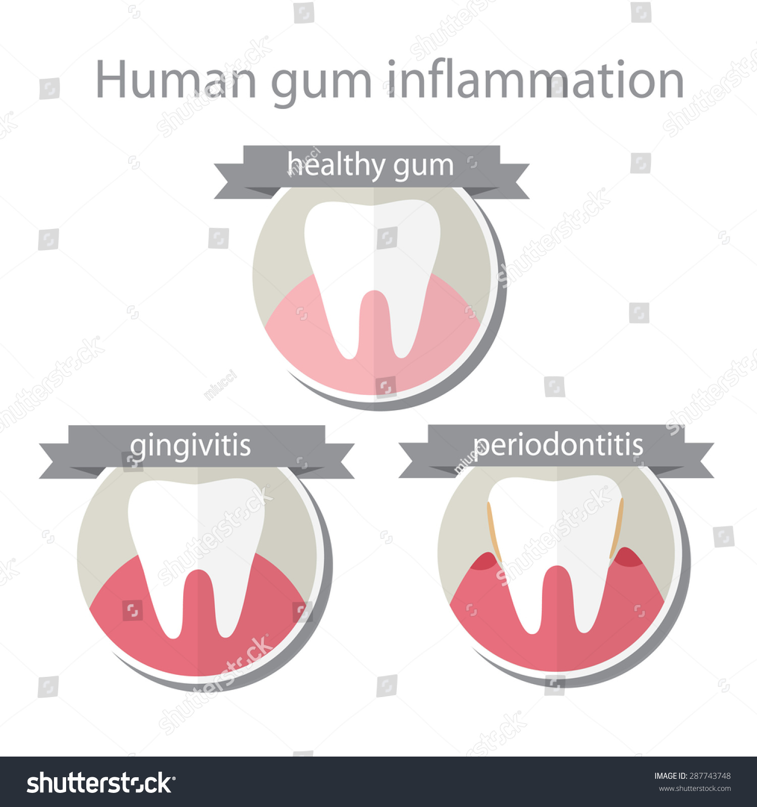 Human Gum Inflammation Eps 10 Vector Stock Vector (Royalty Free ...