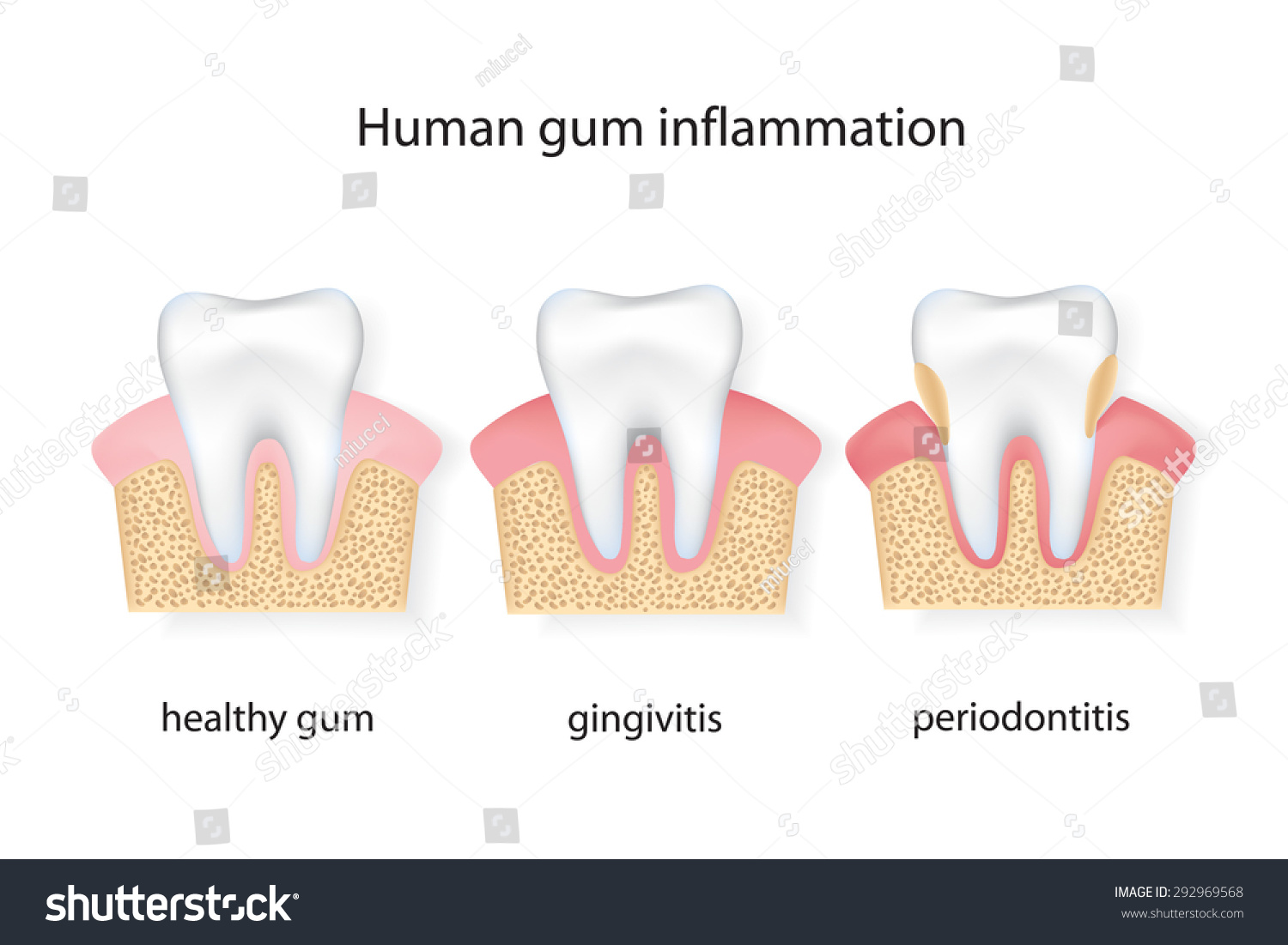Human Gum Inflammation Eps 10 Vector Stock Vector (Royalty Free ...