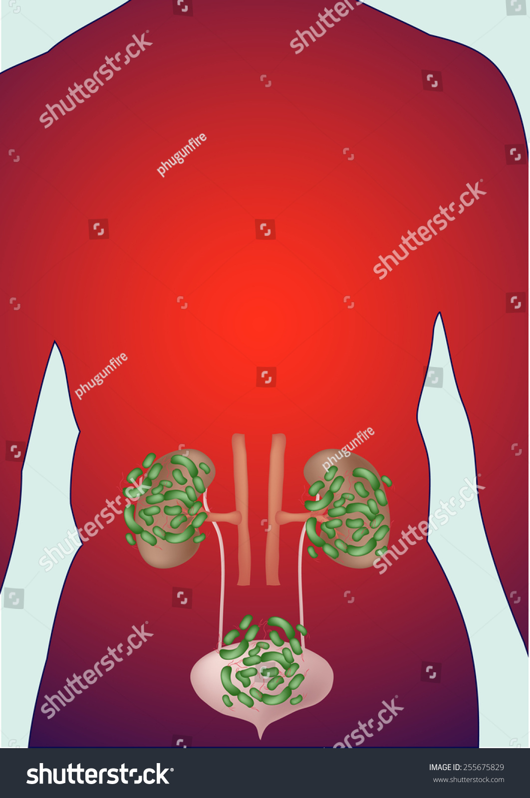 Pyelitis : images, photos et images vectorielles de stock | Shutterstock