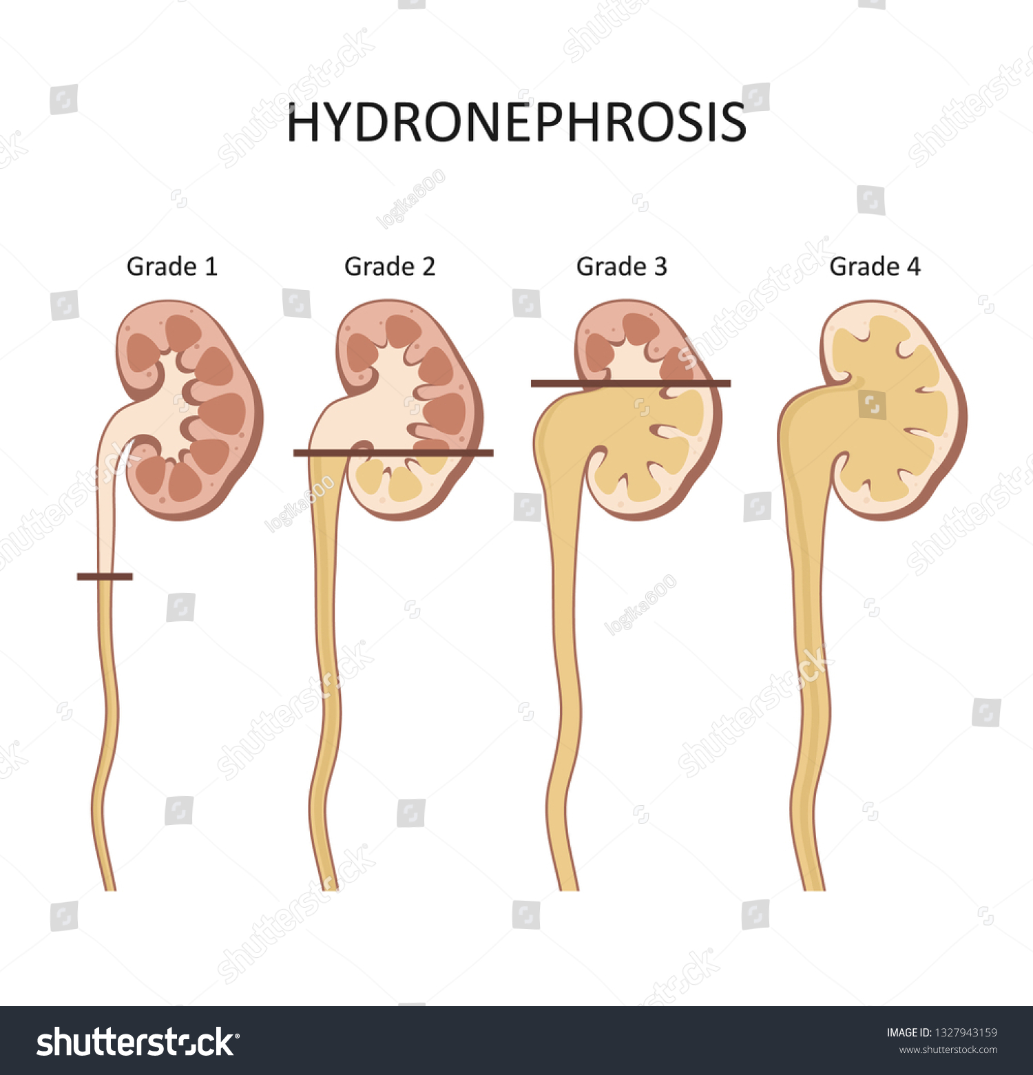 Hydronephrosis Stage Vector Illustration: เวกเตอร์สต็อก (ปลอดค่า ...