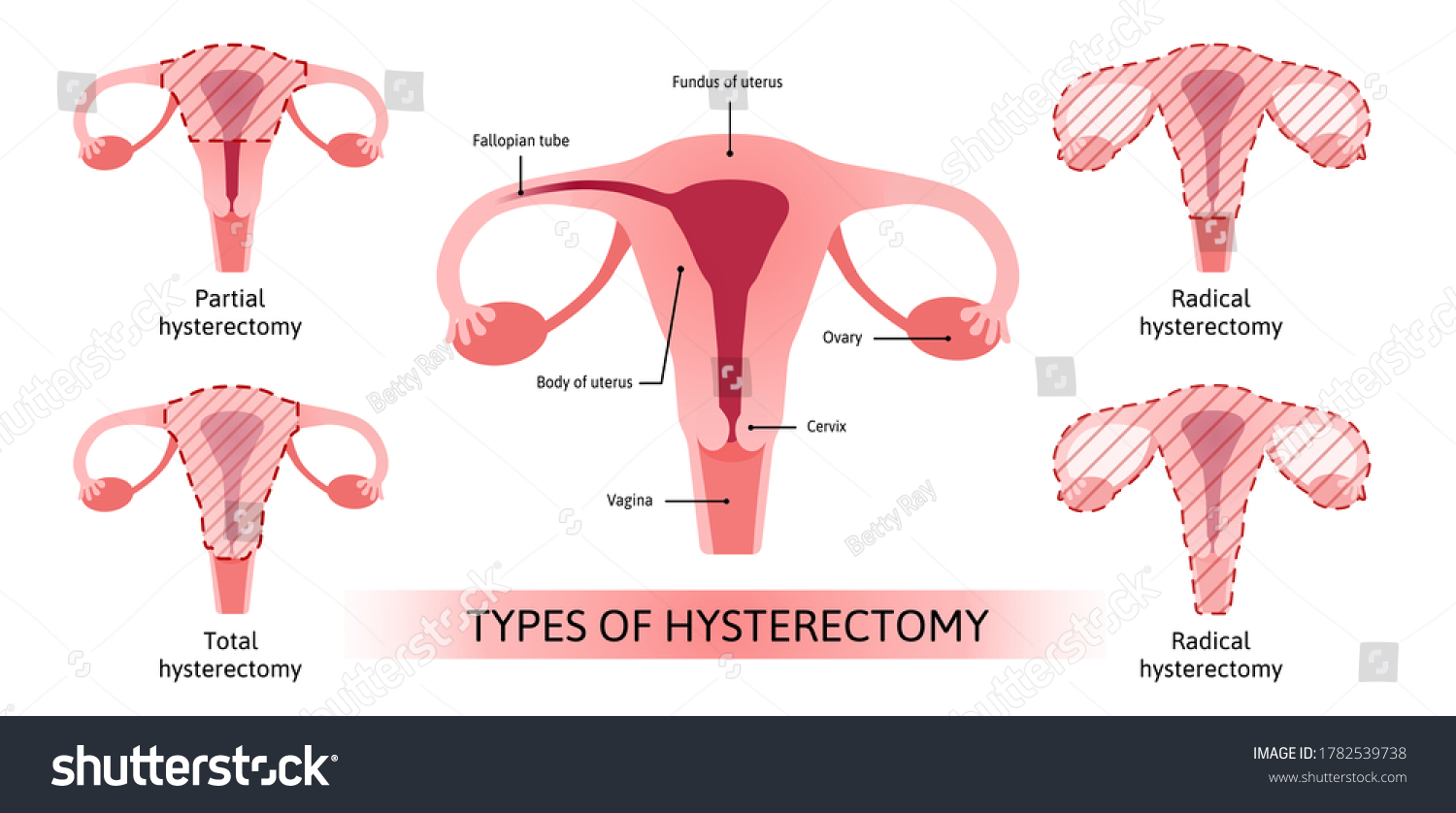 Hysterectomy Surgical Removal Uterus Medical Vector стоковая векторная