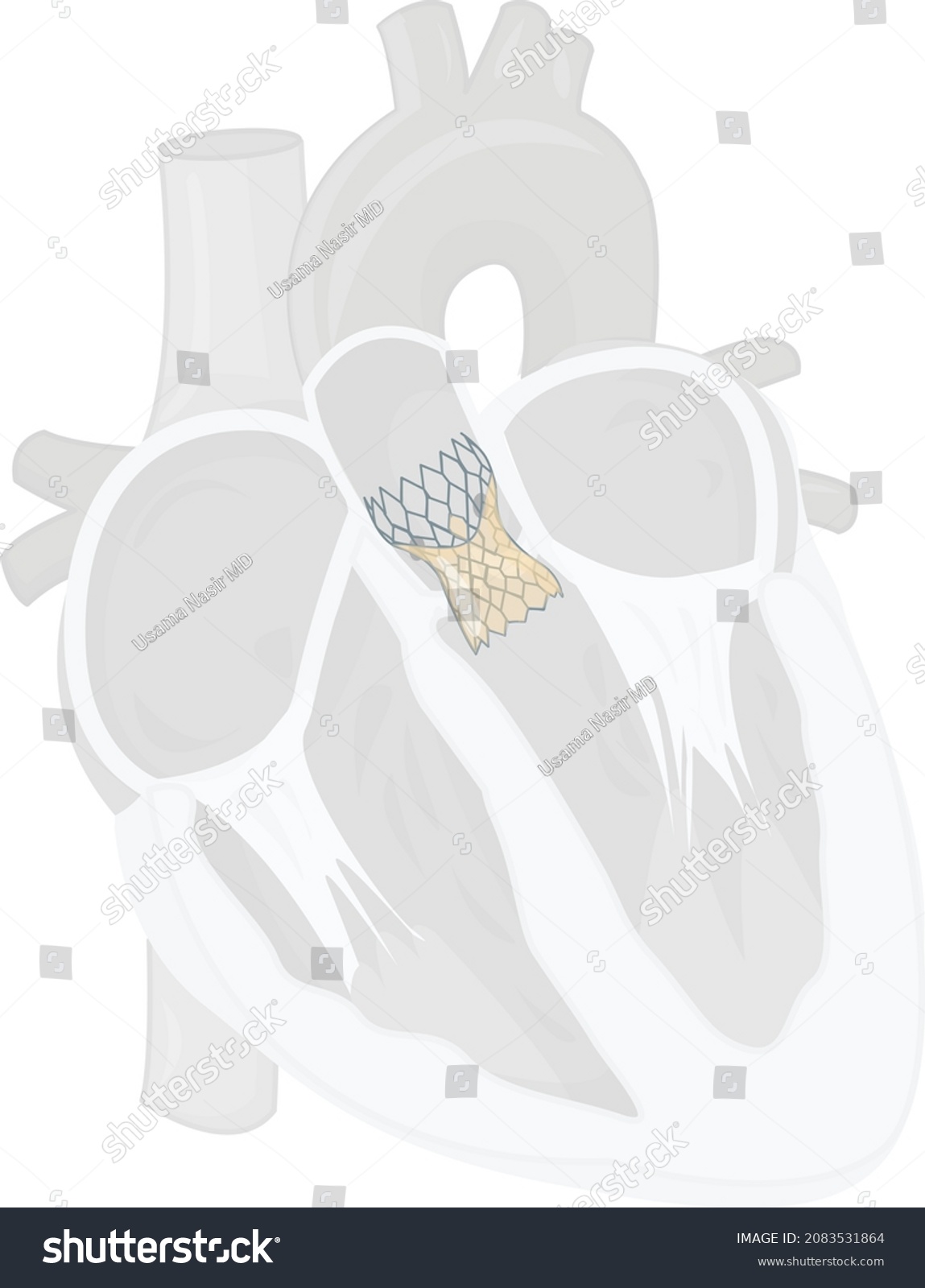 Implanted Tavr Valve Self Expanded Stock Vector (Royalty Free) 2083531864