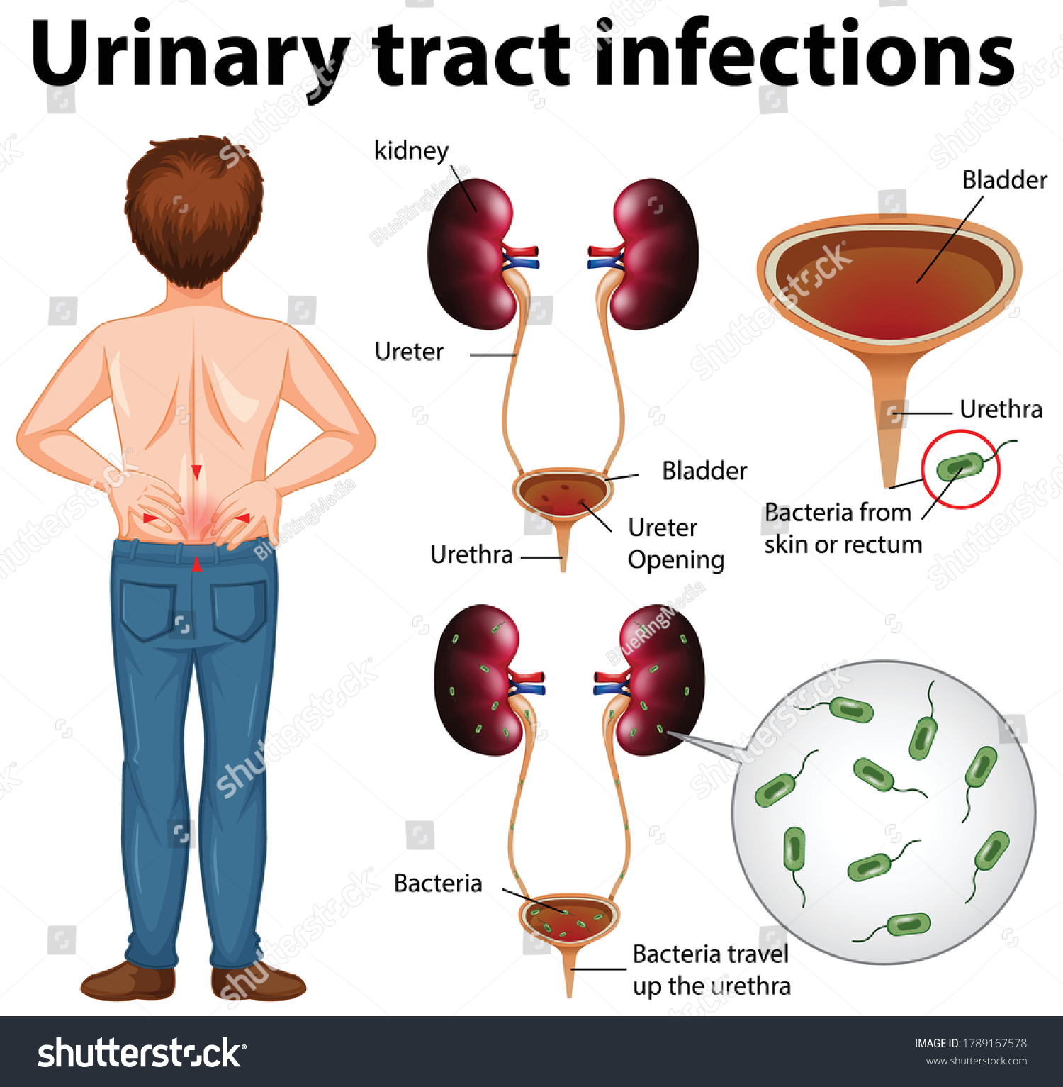 Informative Illustration Urinary Tract Infections Illustration
