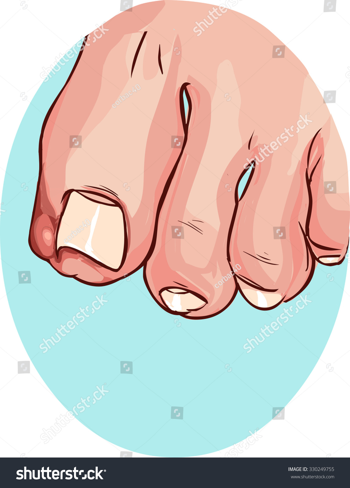 Ingrown Toenail Stock Vector (Royalty Free) 330249755