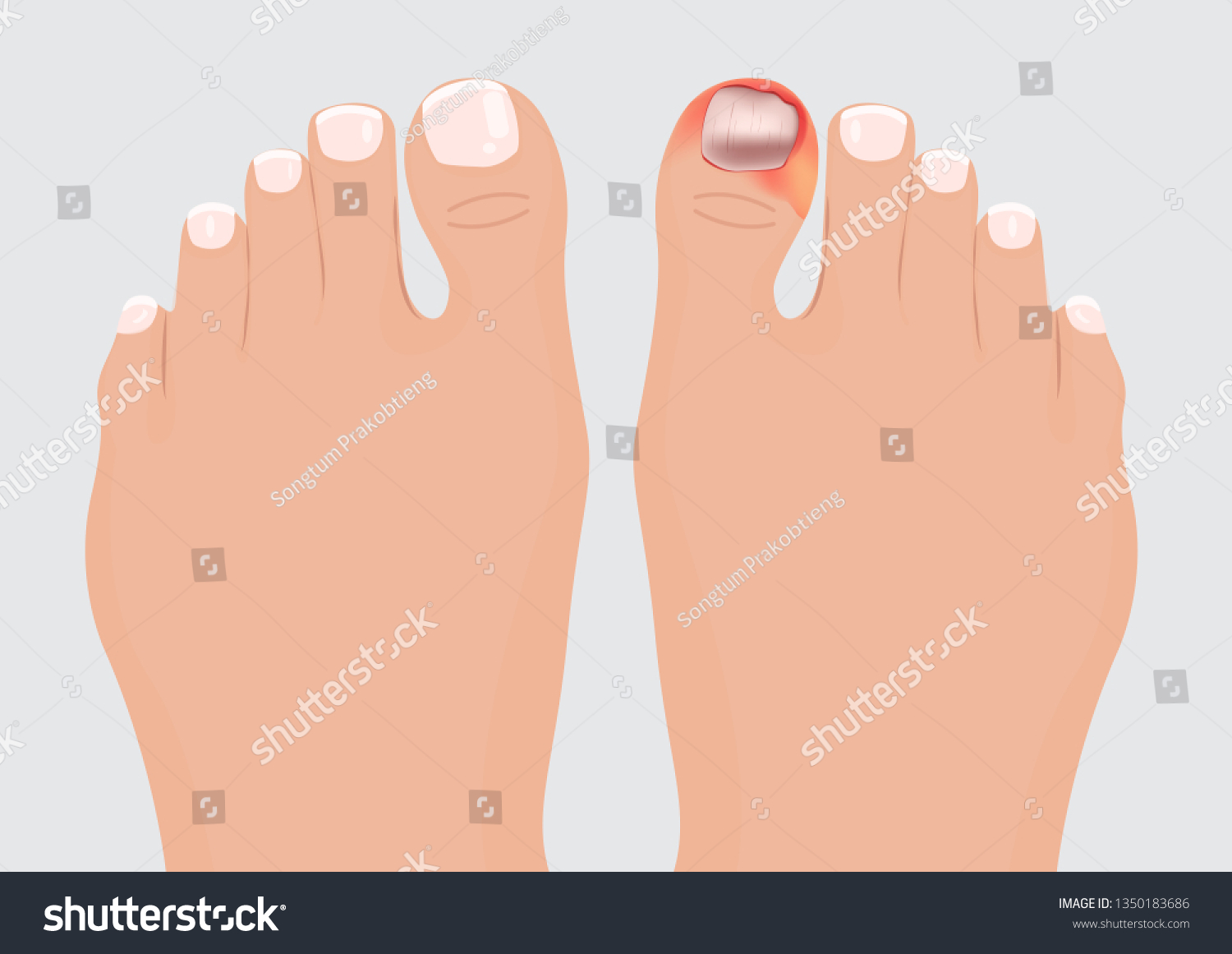 Ingrown Toenail Vector Illustration Stock Vector (Royalty Free) 1350183686