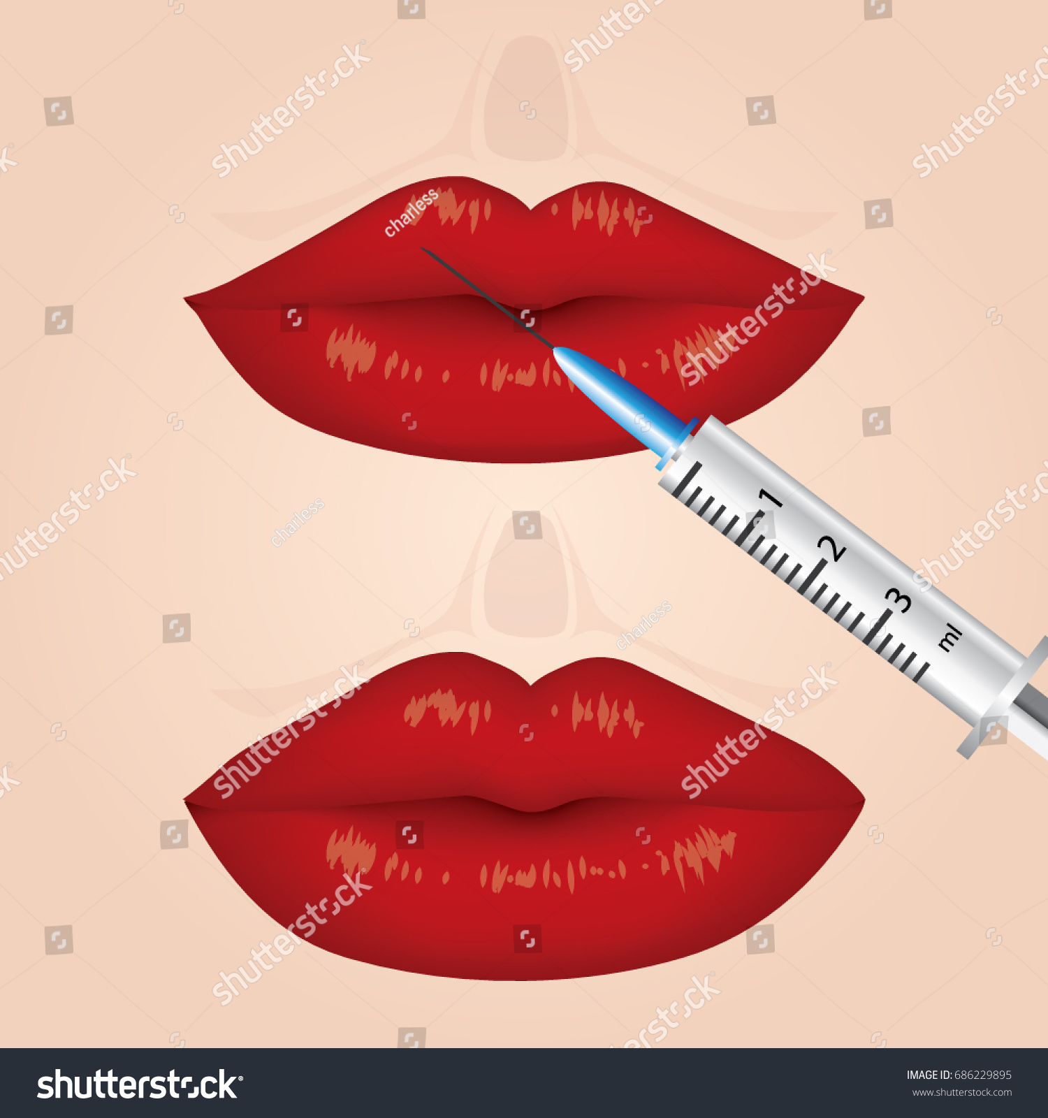 Lip Injection Before After Vector Illustration Stock Vector (Royalty ...