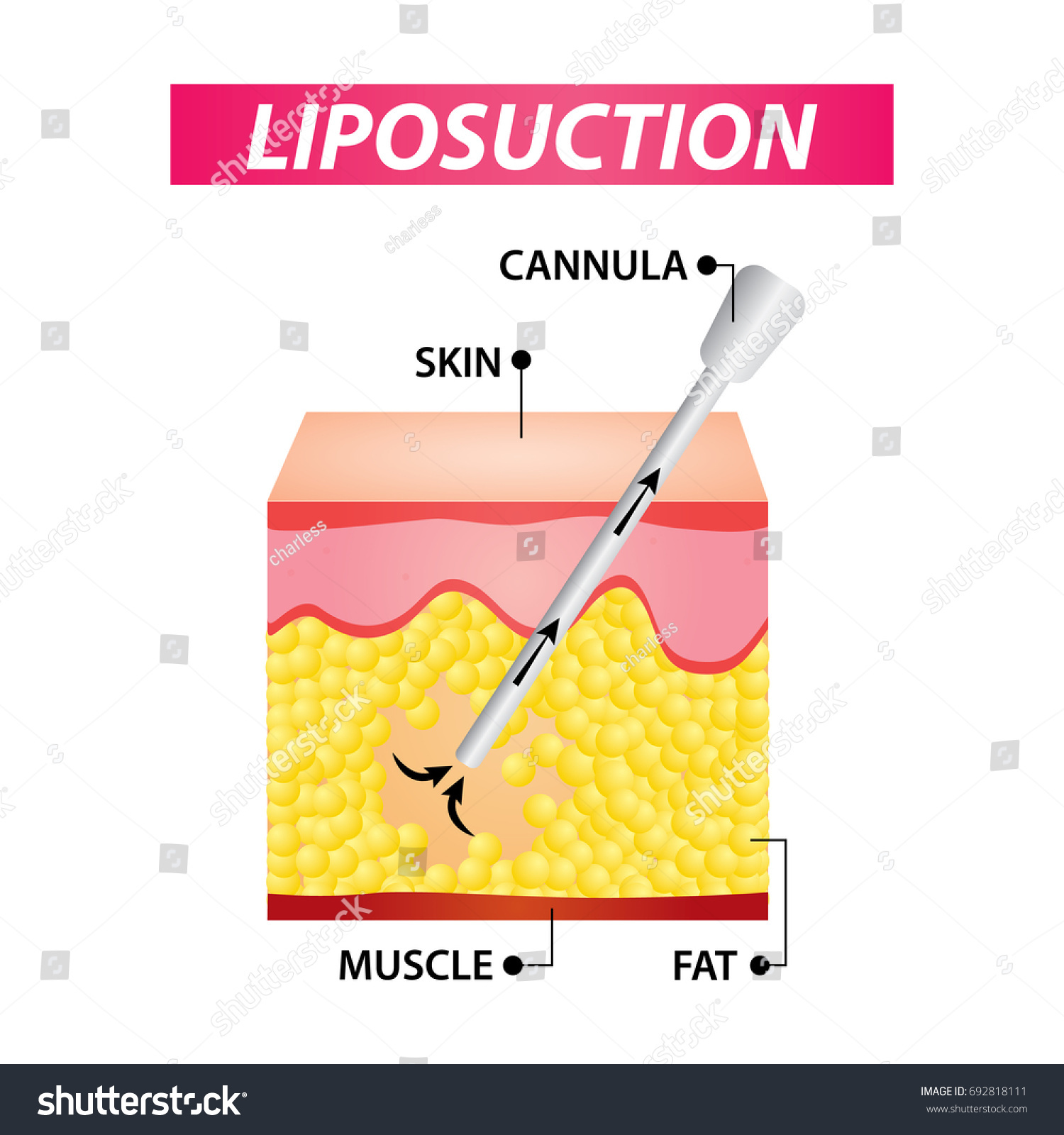 Liposuction Fat Surgery Vector Illustration Stock Vector (Royalty Free ...