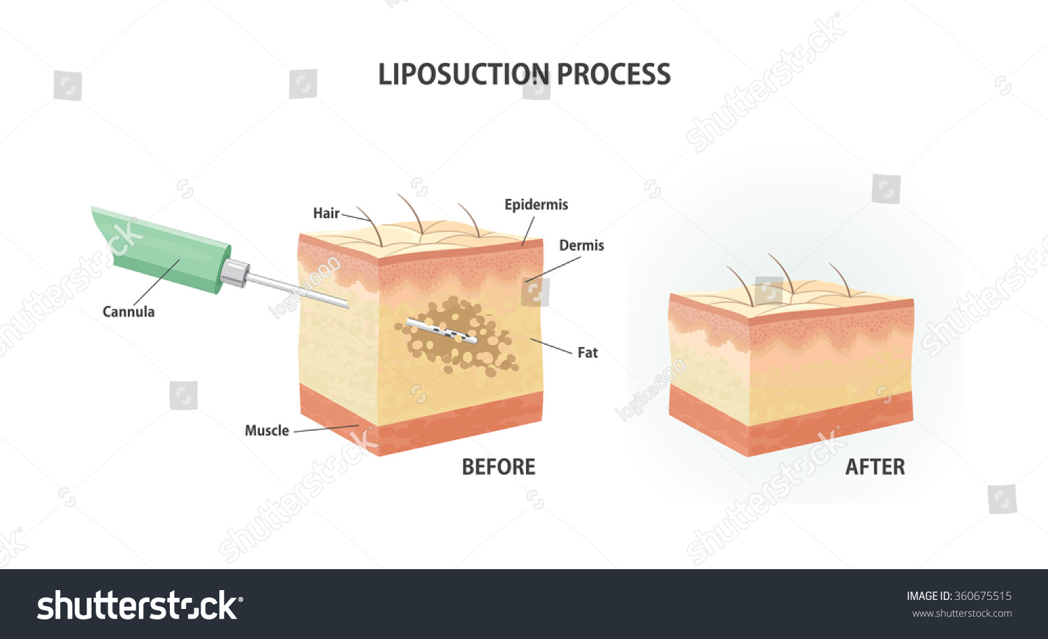 Liposuction Processsuctionassisted Liposuction Vector Illustration ...