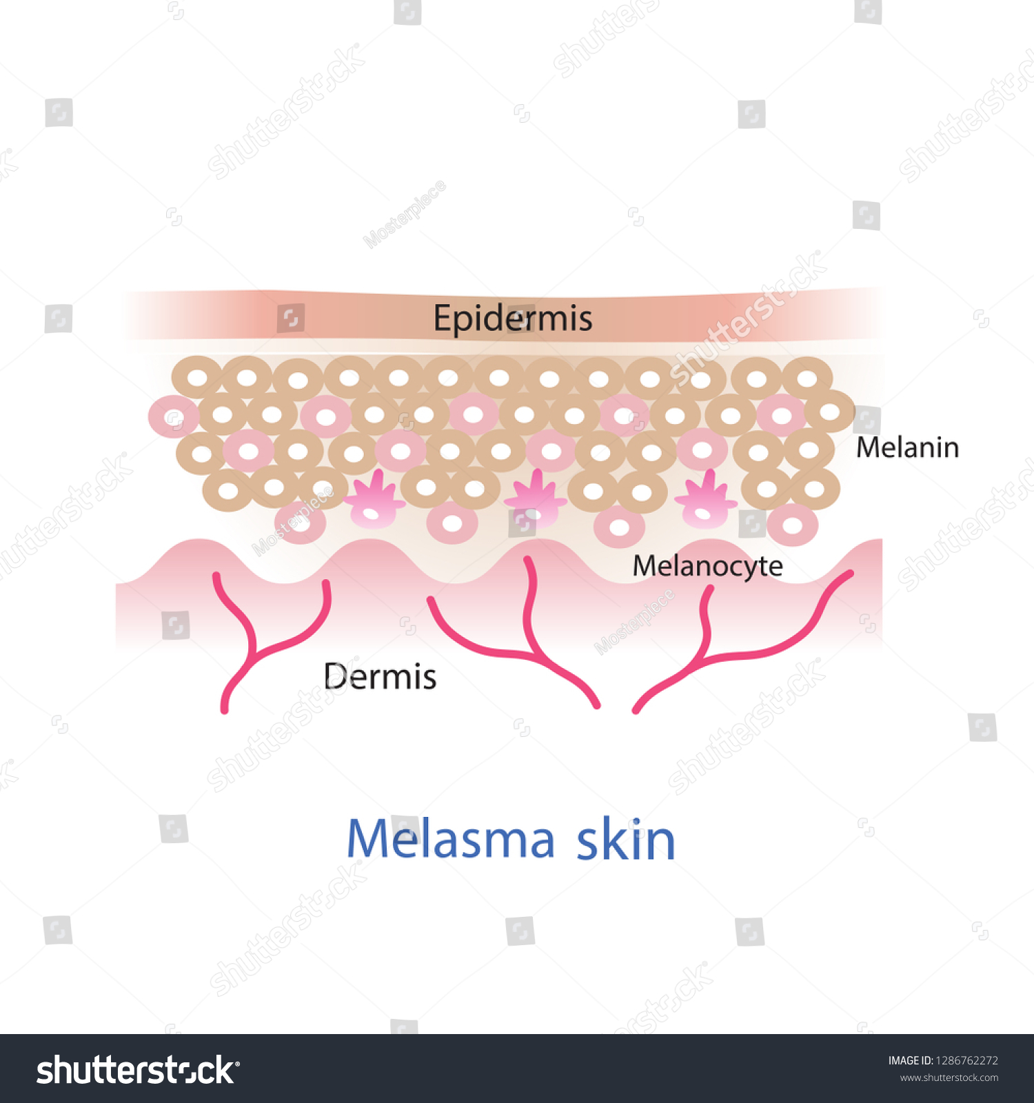 Melasma Skin Layer Vector On White Stock Vector (Royalty Free) 1286762272