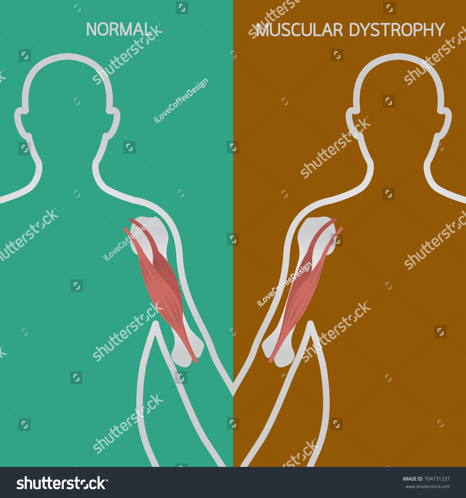 Muscular Dystrophy Vector Illustration: vector de stock (libre de ...