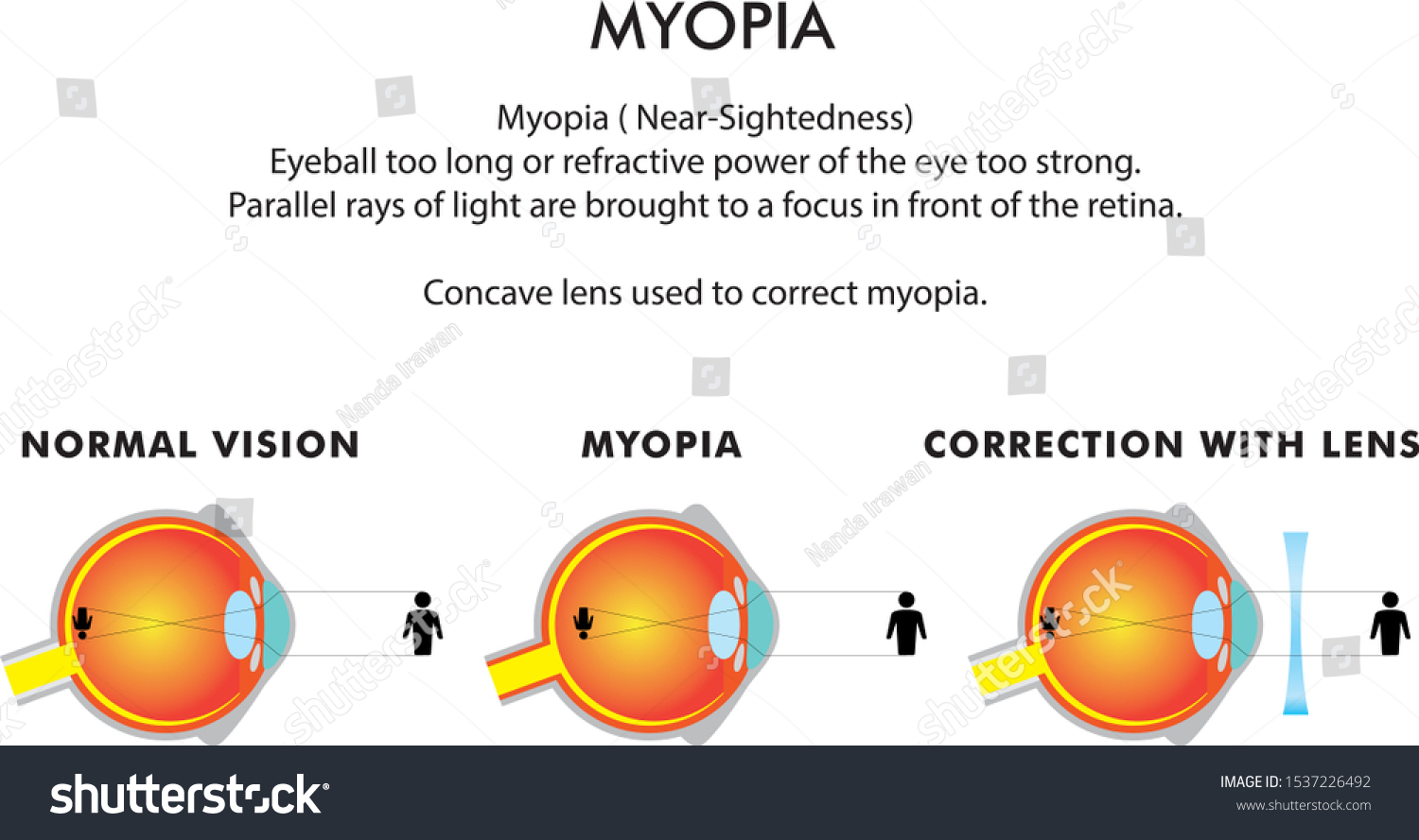 Vektor Stok Myopia Vision Disorders Astigmatism Hyperopia (Tanpa ...