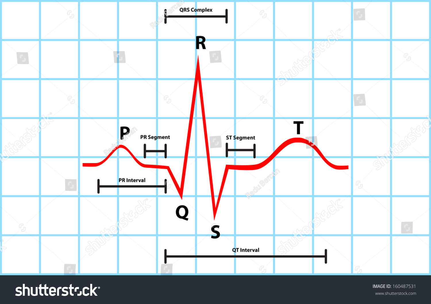 Normal Atrial Ventricular Depolarization Electrocardiogram Description ...
