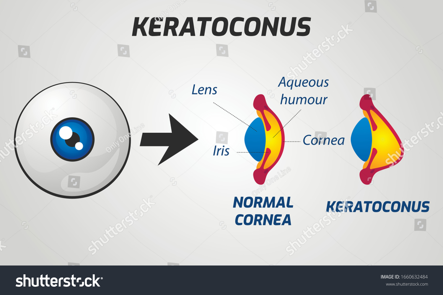 Normal Cornea Keratoconus Concept Vector Illustration Stock Vector ...