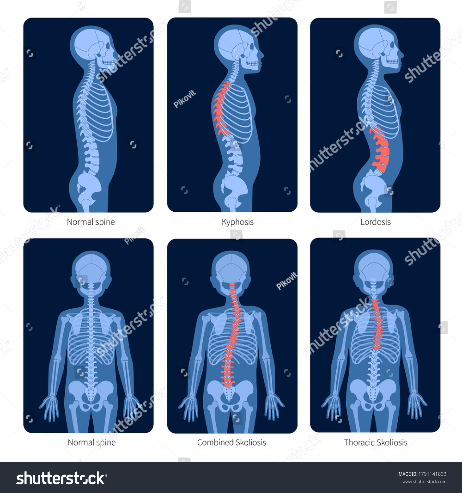 Normal Spine Types Spine Defects Scoliosis: vetor stock (livre de ... Normal Spine Types Spine Defects Scoliosis: vetor stock (livre de ...