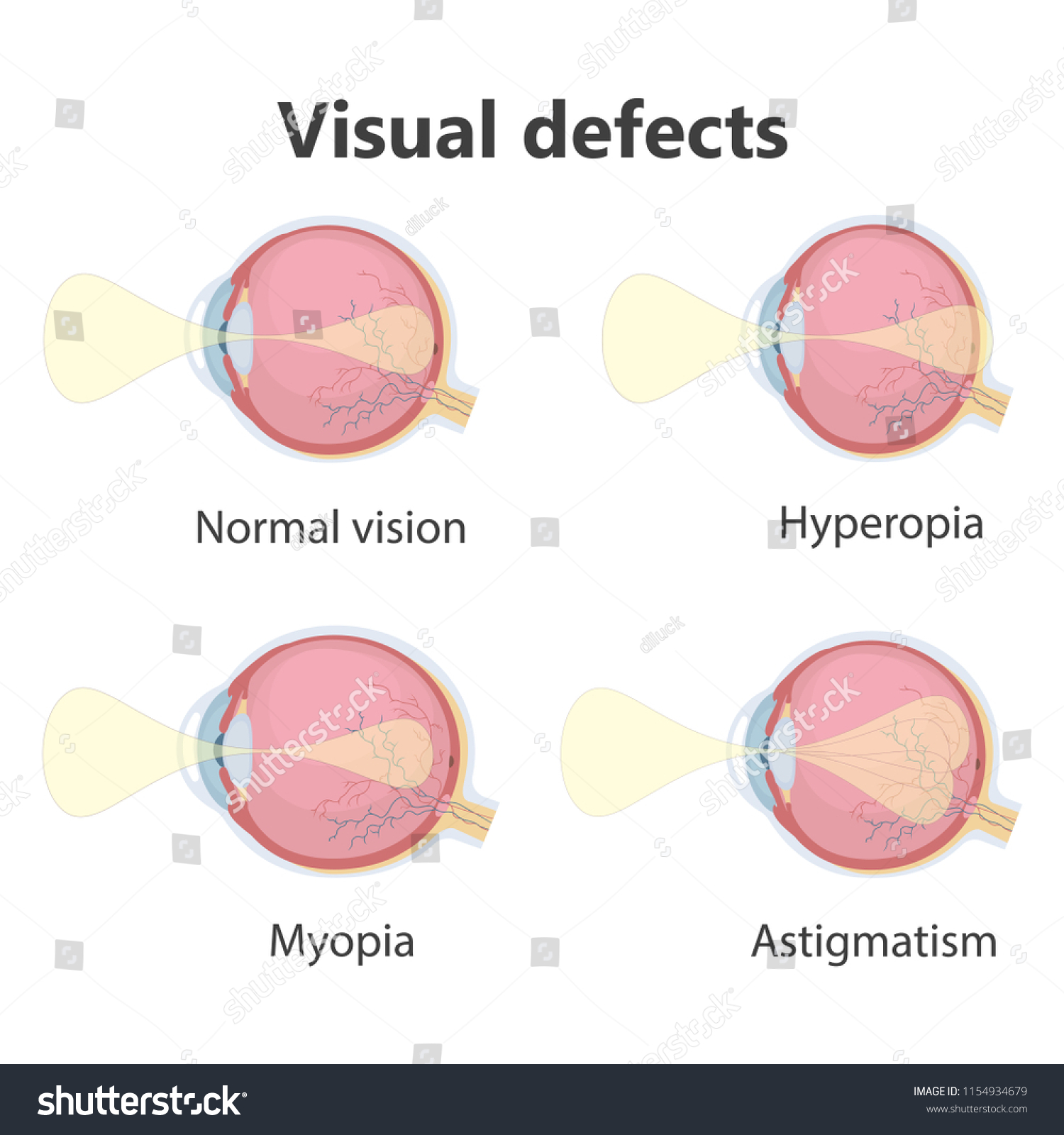 Ophthalmic Concept Eye Defects Normal Vision: เวกเตอร์สต็อก (ปลอดค่า ...