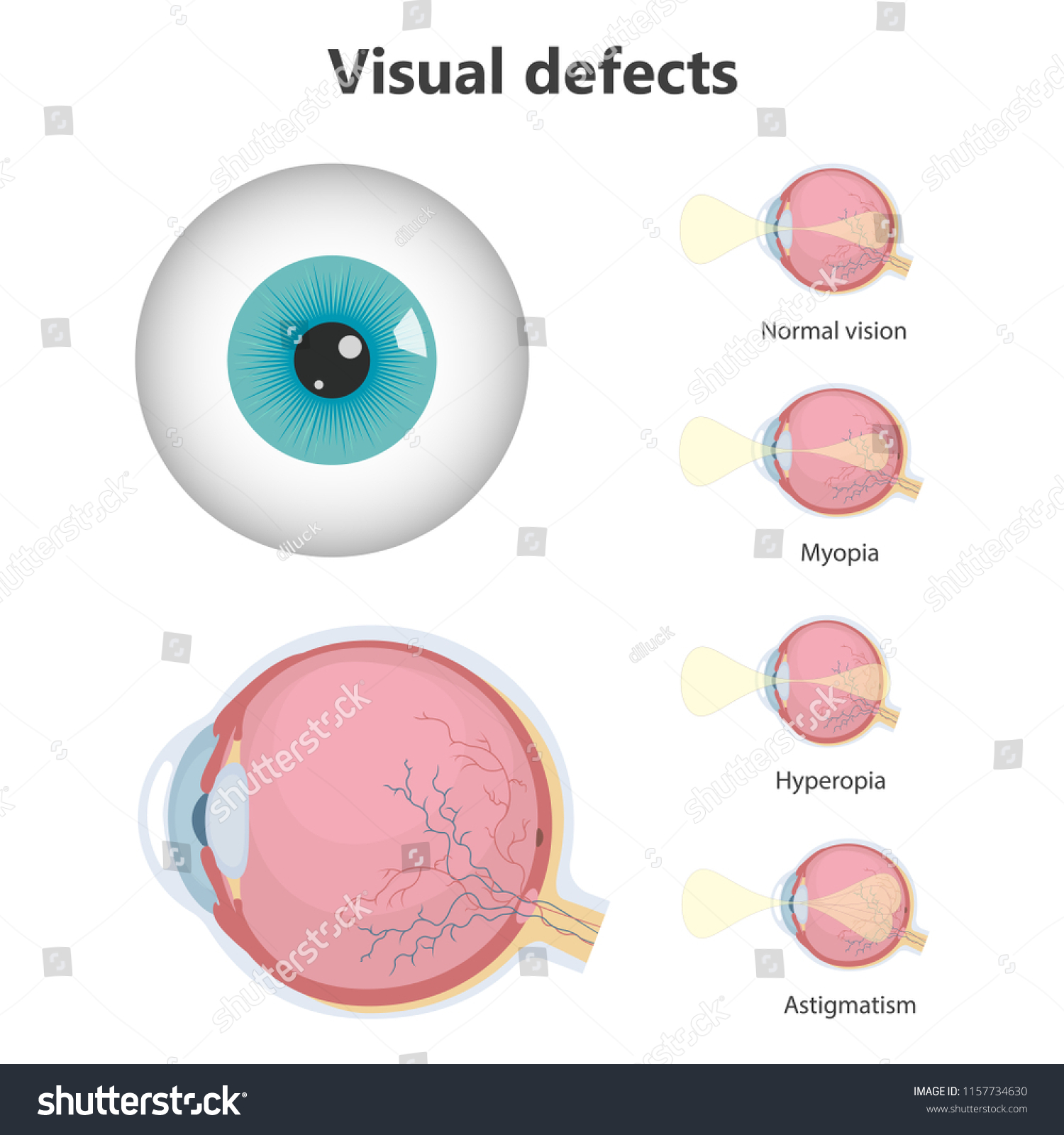 Ophthalmic Concept Eye Defects Normal Vision庫存向量圖（免版稅）1157734630 ...