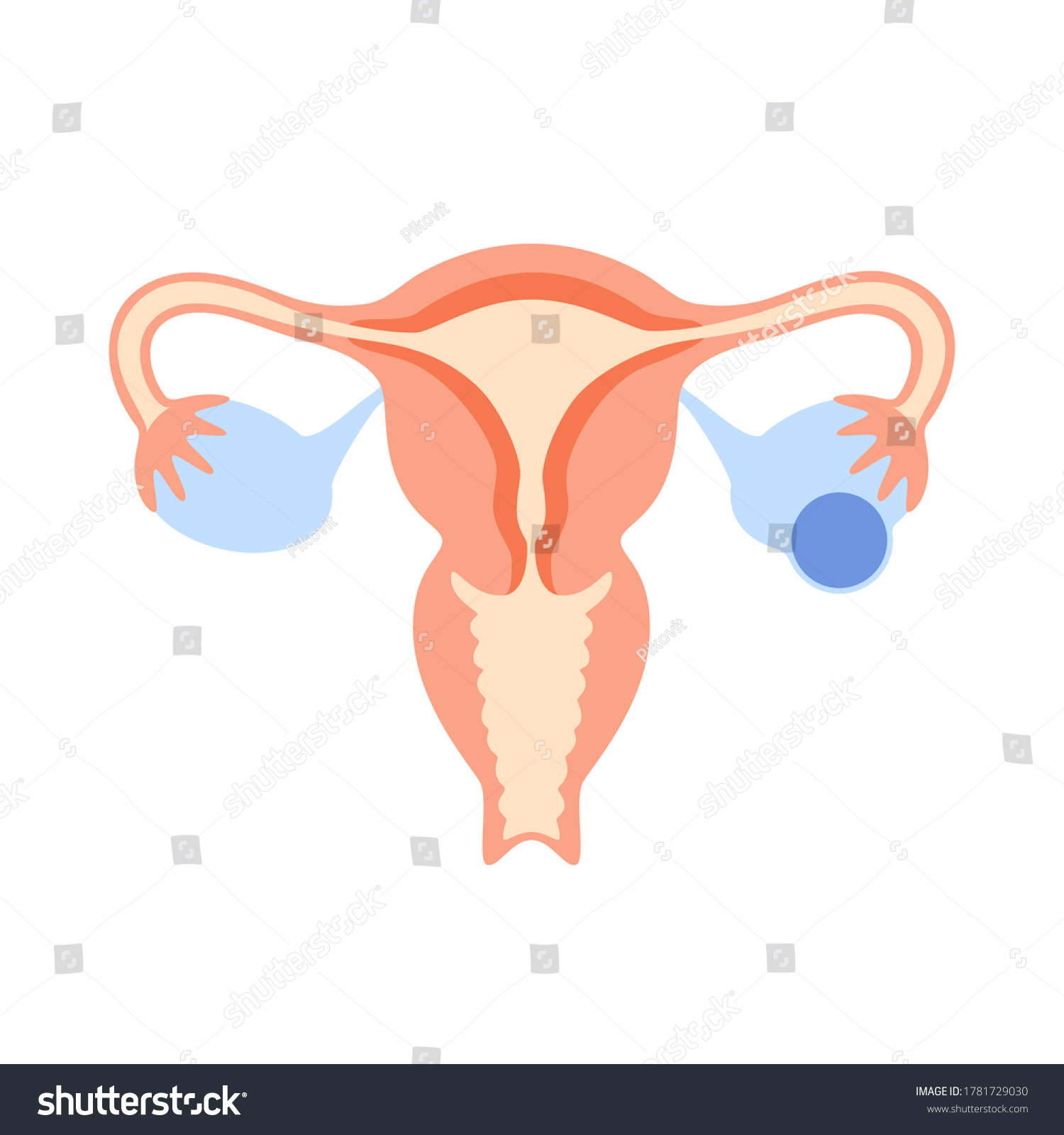 Ovarian Cyst Uterus Flat Vector Illustration Vetor Stock Livre De Direitos 1781729030