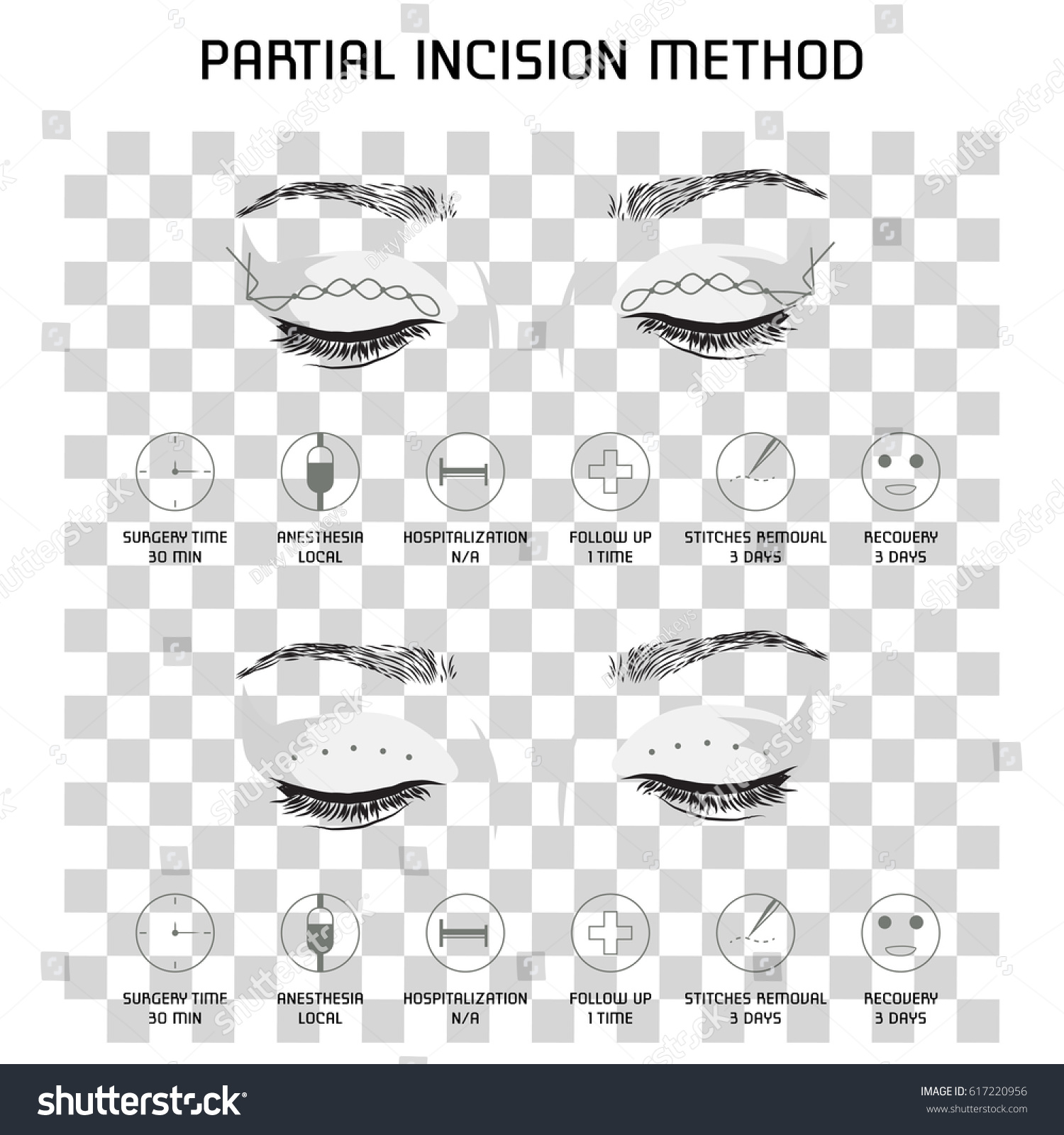 Partial Incision Method Vector Illustration Medical: vector de stock ...