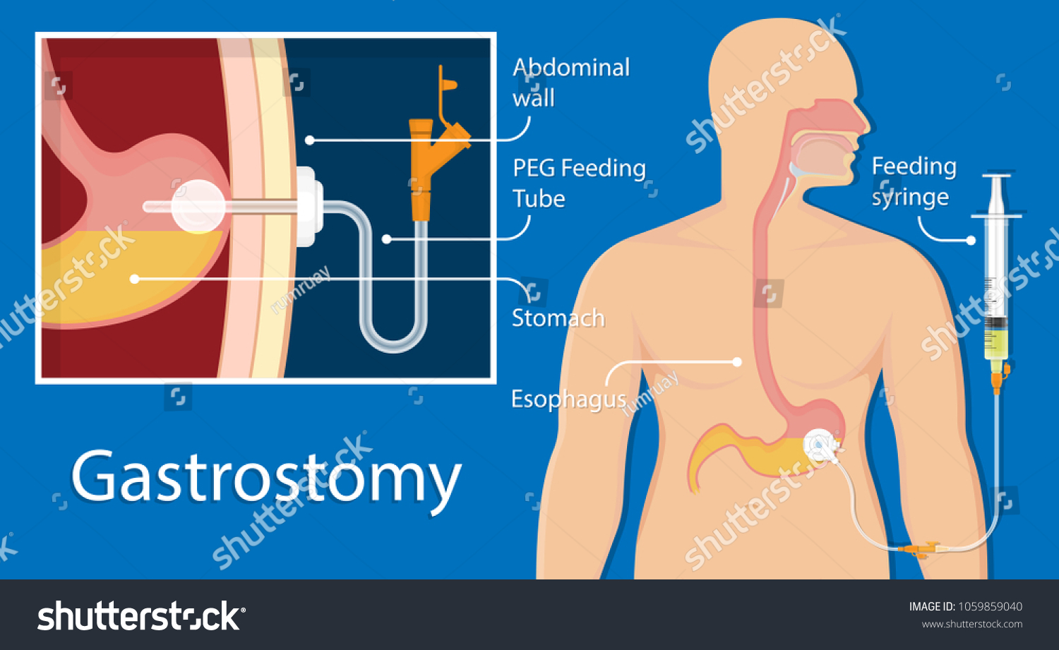 Percutaneous endoscopic gastrostomy Images, Stock Photos & Vectors ... Percutaneous endoscopic gastrostomy Images, Stock Photos & Vectors ...