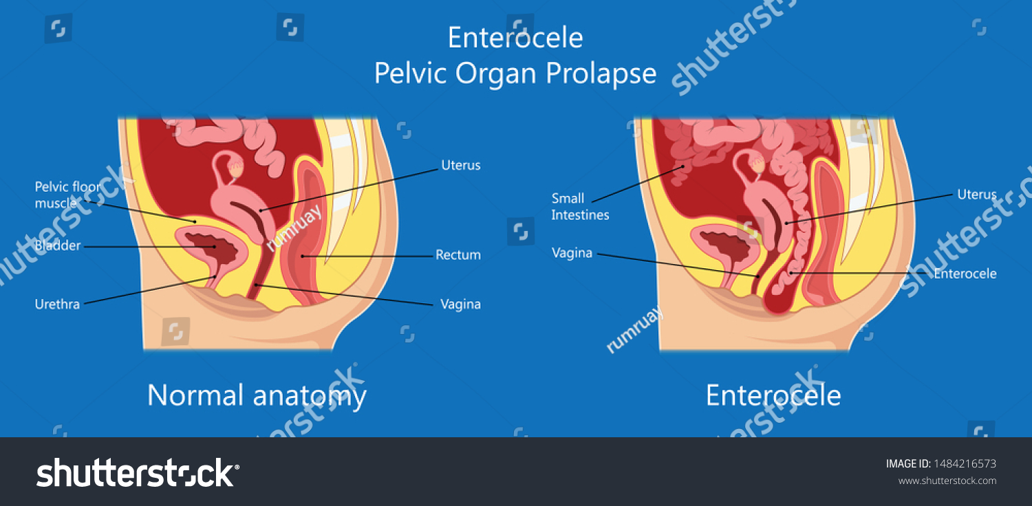Pelvic Floor Prolapse Type Uterine Uterus Stock Vector Royalty Free