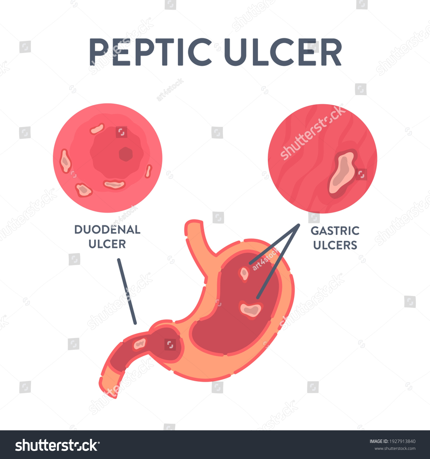 Peptic Ulcer Stomach Disease Infographic Poster Stock Vector Royalty