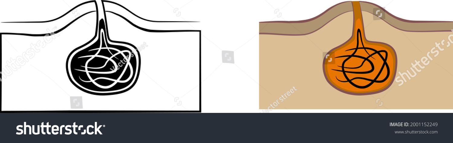 Pilonidal Cyst Icon Vector Illustration Stock Vector (Royalty Free ...