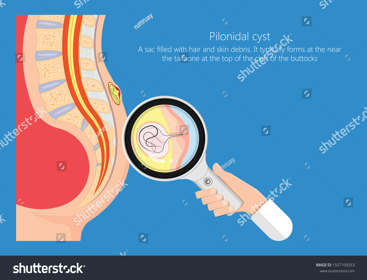 Pilonidal Cyst Nest Hair Causes Excessive Stock Vector Royalty Free 1557105053