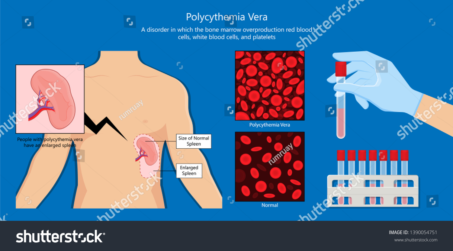 Polycythemia Vera Pv Blood Clots Cancer : image vectorielle de stock (libre de droits ...