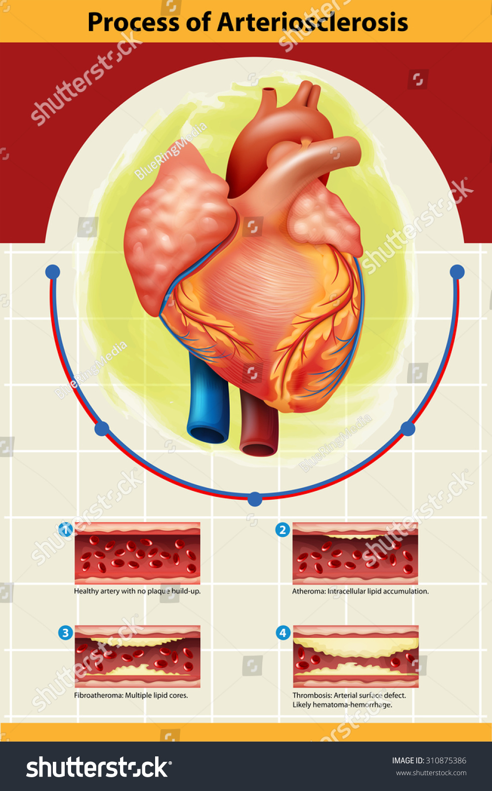 Poster Arteriosclerosis Process Illustration Stock Vector (Royalty Free ... Poster Arteriosclerosis Process Illustration Stock Vector (Royalty Free ...