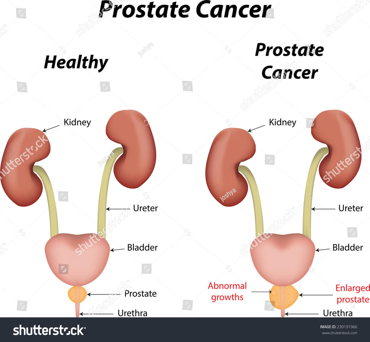 Prostate Cancer Stock Vector Illustration 230191966 Shutterstock