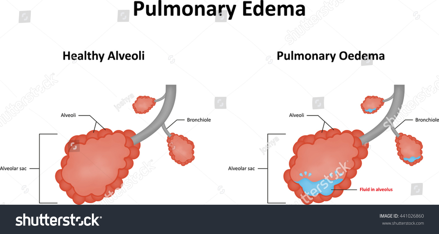 Pulmonary Edema Stock Vector (Royalty Free) 441026860 - Shutterstock