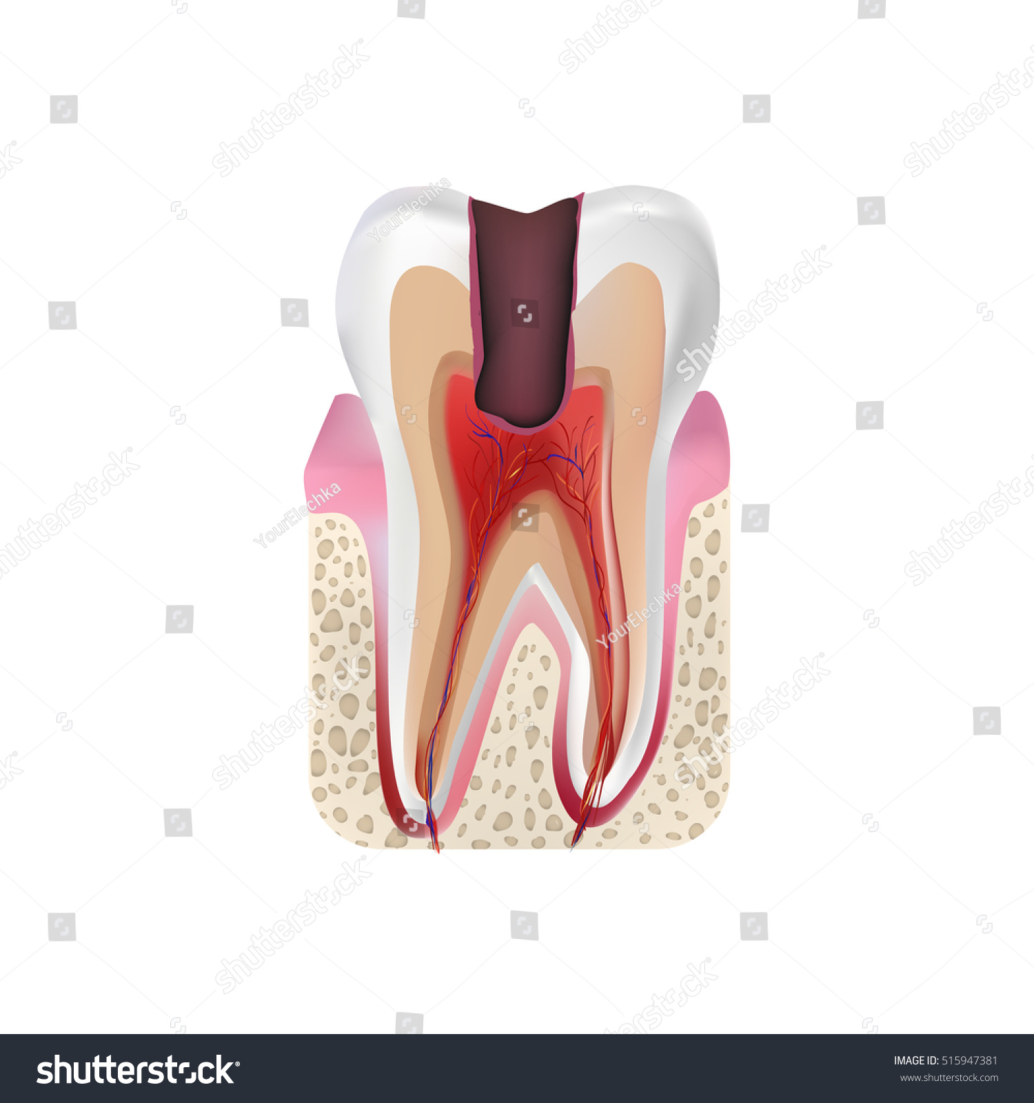 「Pulpitis Inflamed Pulp Tissue Vector Illustration」のベクター画像素材（ロイヤリティフリー ...