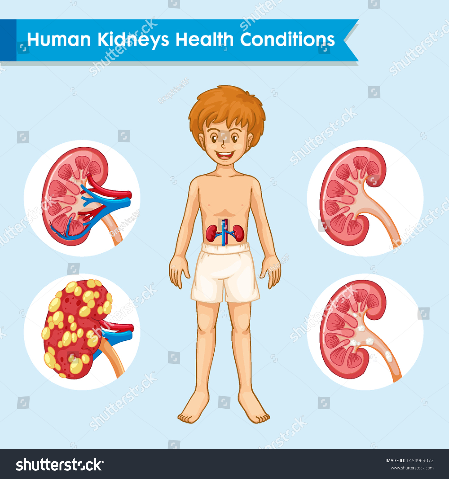Scientific Medical Illustration Kidney Disease Illustration Stock ... Scientific Medical Illustration Kidney Disease Illustration Stock ...
