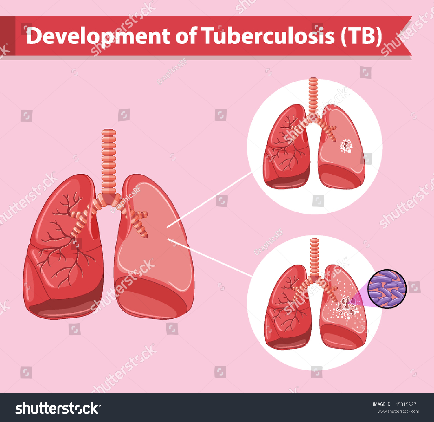 Scientific Medical Illustration Tuberculosis Illustration Stock Vector ... Scientific Medical Illustration Tuberculosis Illustration Stock Vector ...