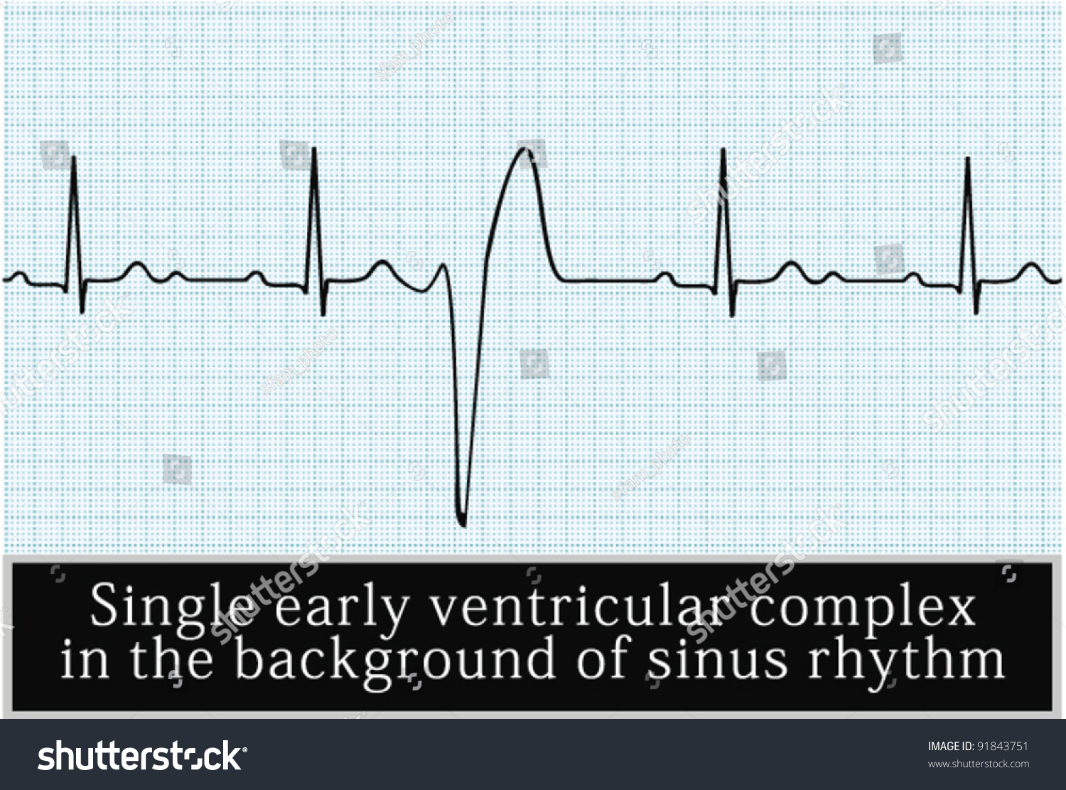 Sinus Rhythm On Ecg Vector Professional Stok Vektör (Telifsiz) 91843751 ...
