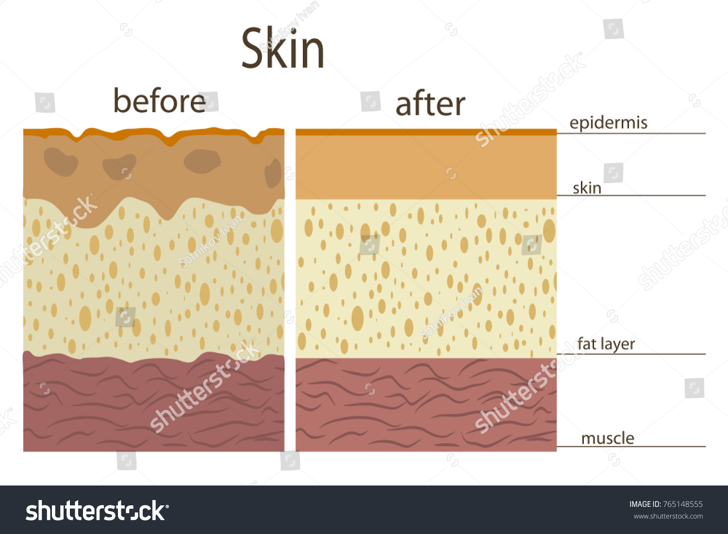 Skin Before After Stock Vector (Royalty Free) 765148555