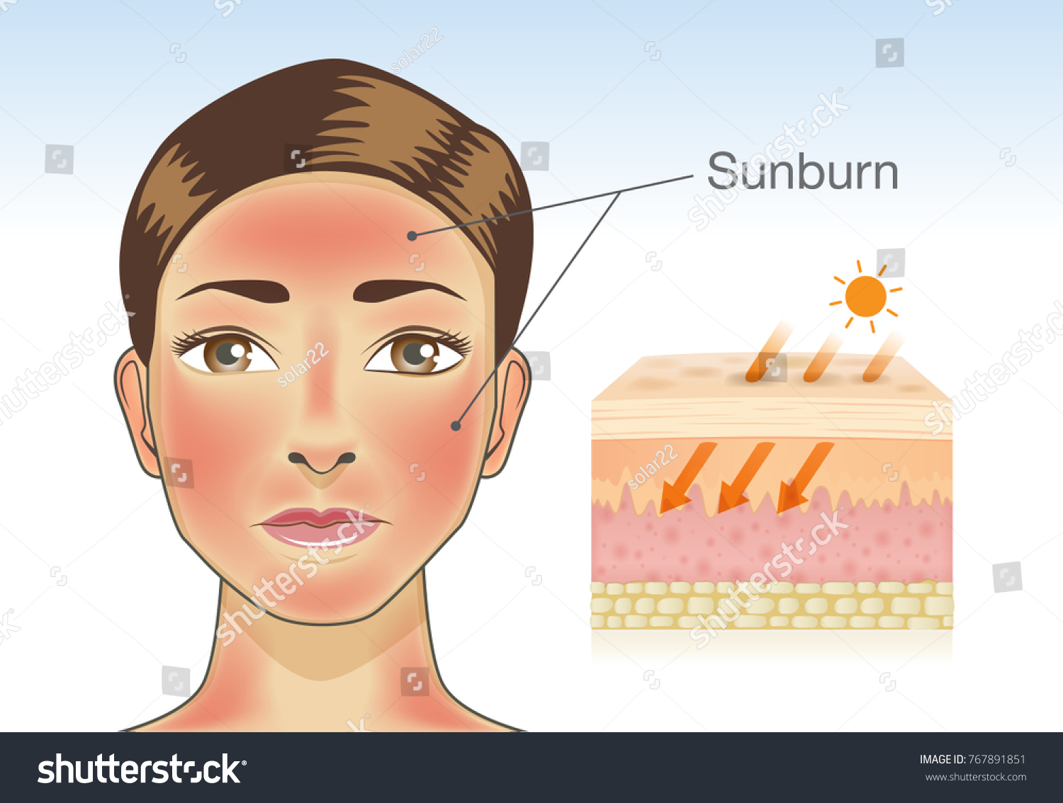 Skin Layer Woman Which Appear Redness Stock Vector Royalty Free