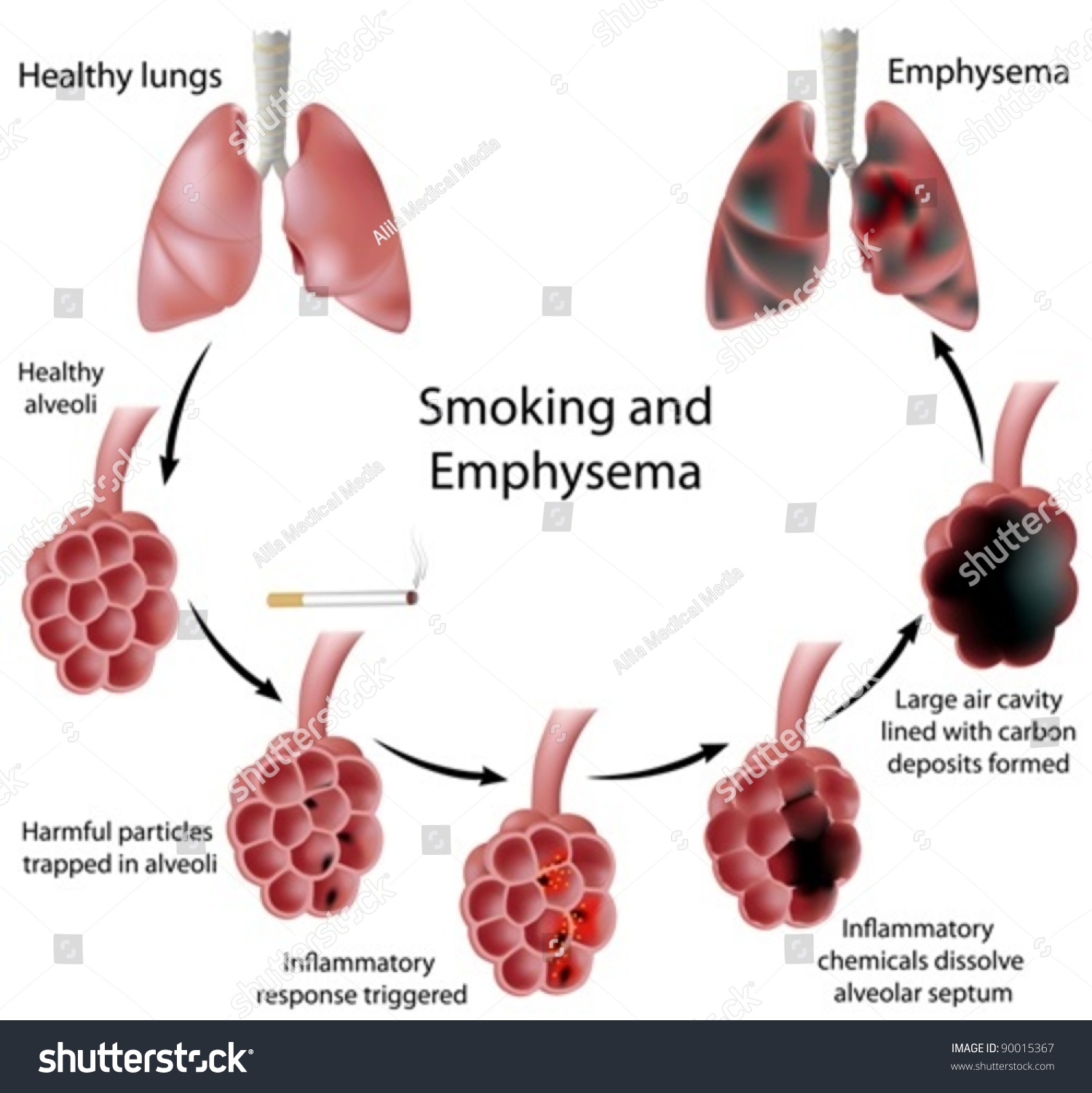 Smoking And Emphysema Stock Vector Illustration 90015367 : Shutterstock