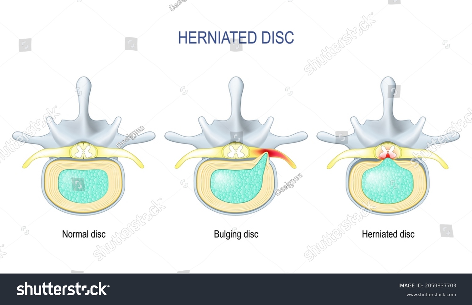 236 Nerve root compression Images, Stock Photos & Vectors | Shutterstock