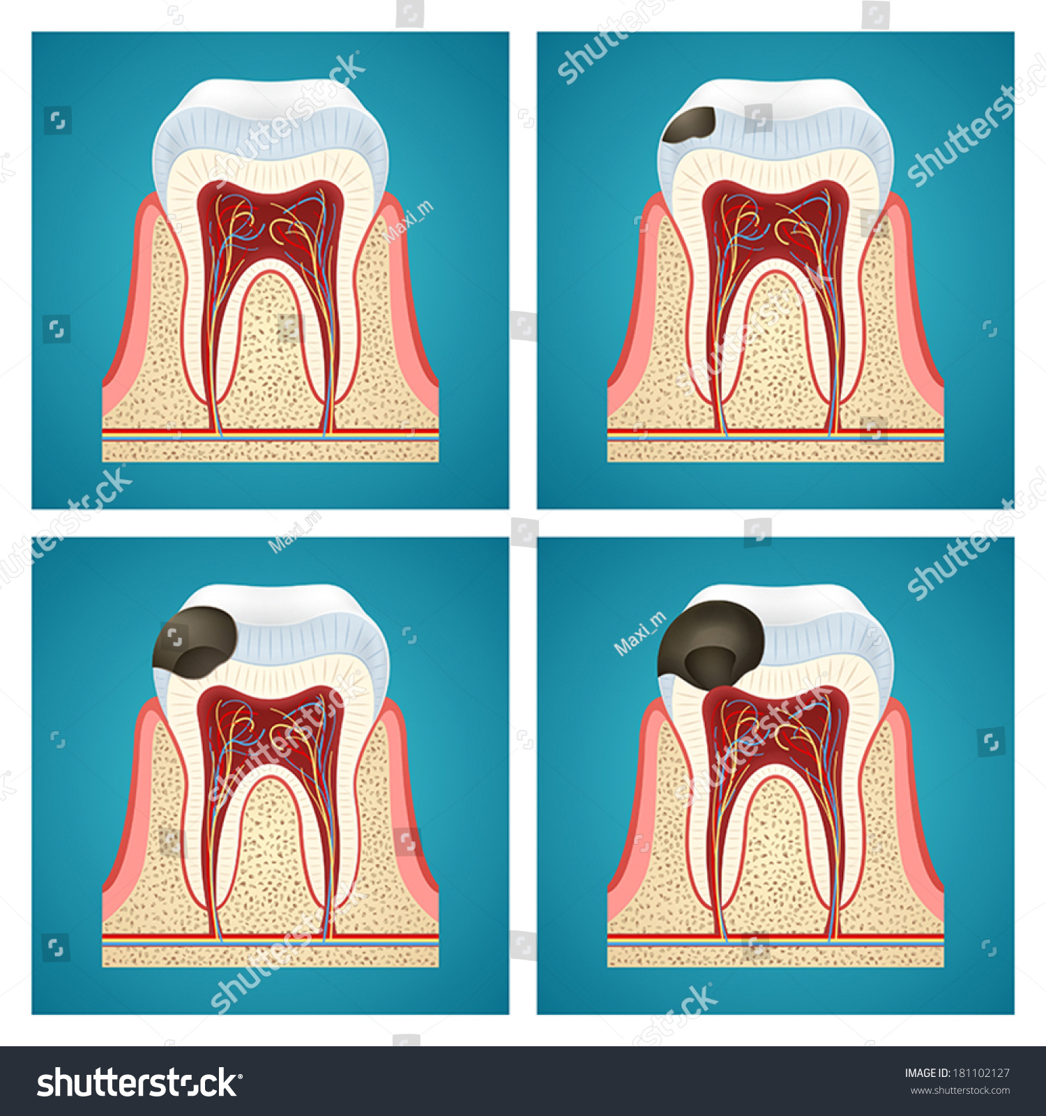 Stages Progress Caries On Human Teeth 스톡 벡터(로열티 프리) 181102127 ...